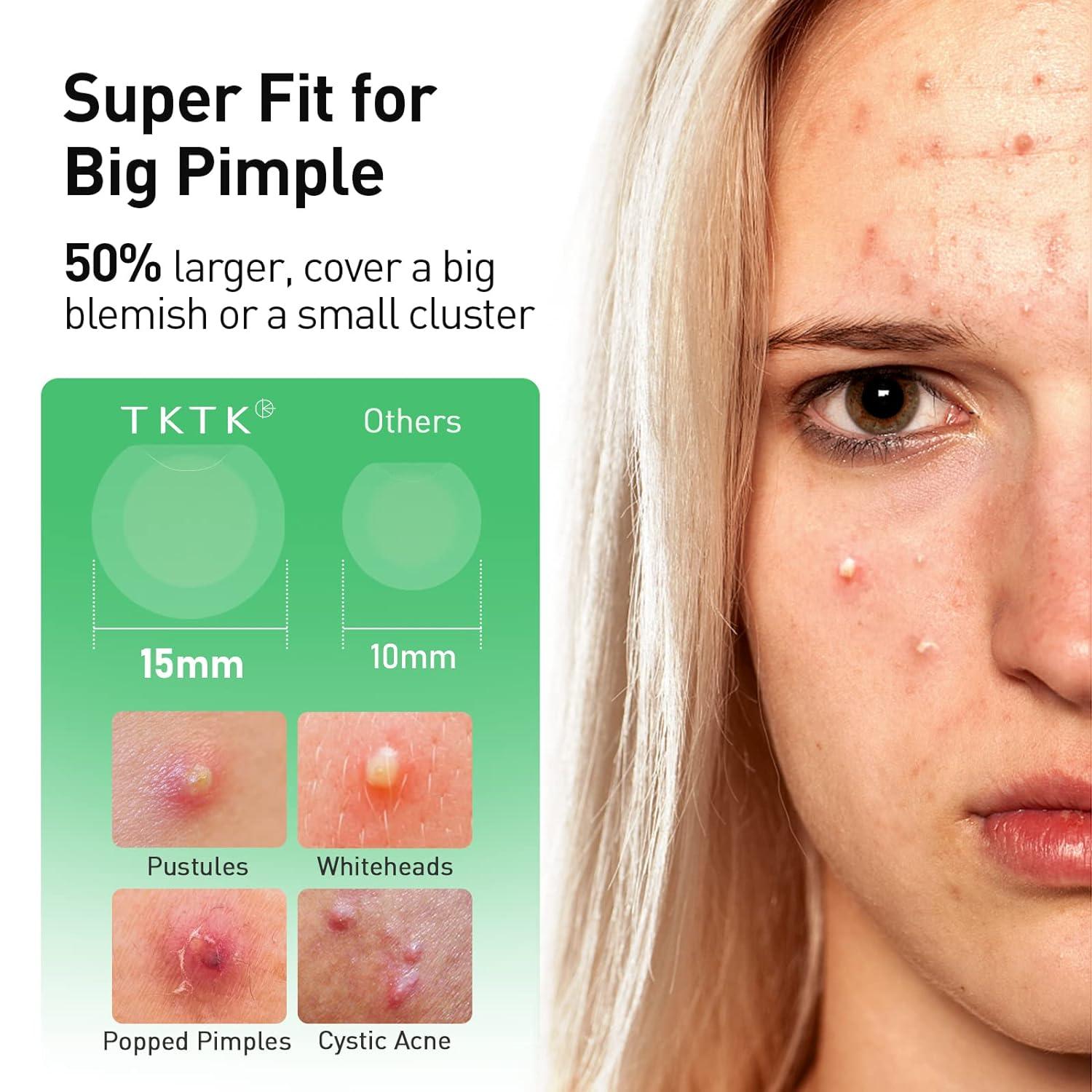 Cystic Pimple On Cheek