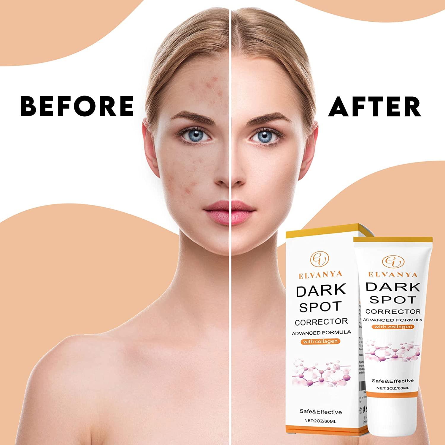 Dark Spot Remover for Face & Underarms - Moisturizing Cream for Armpits ...