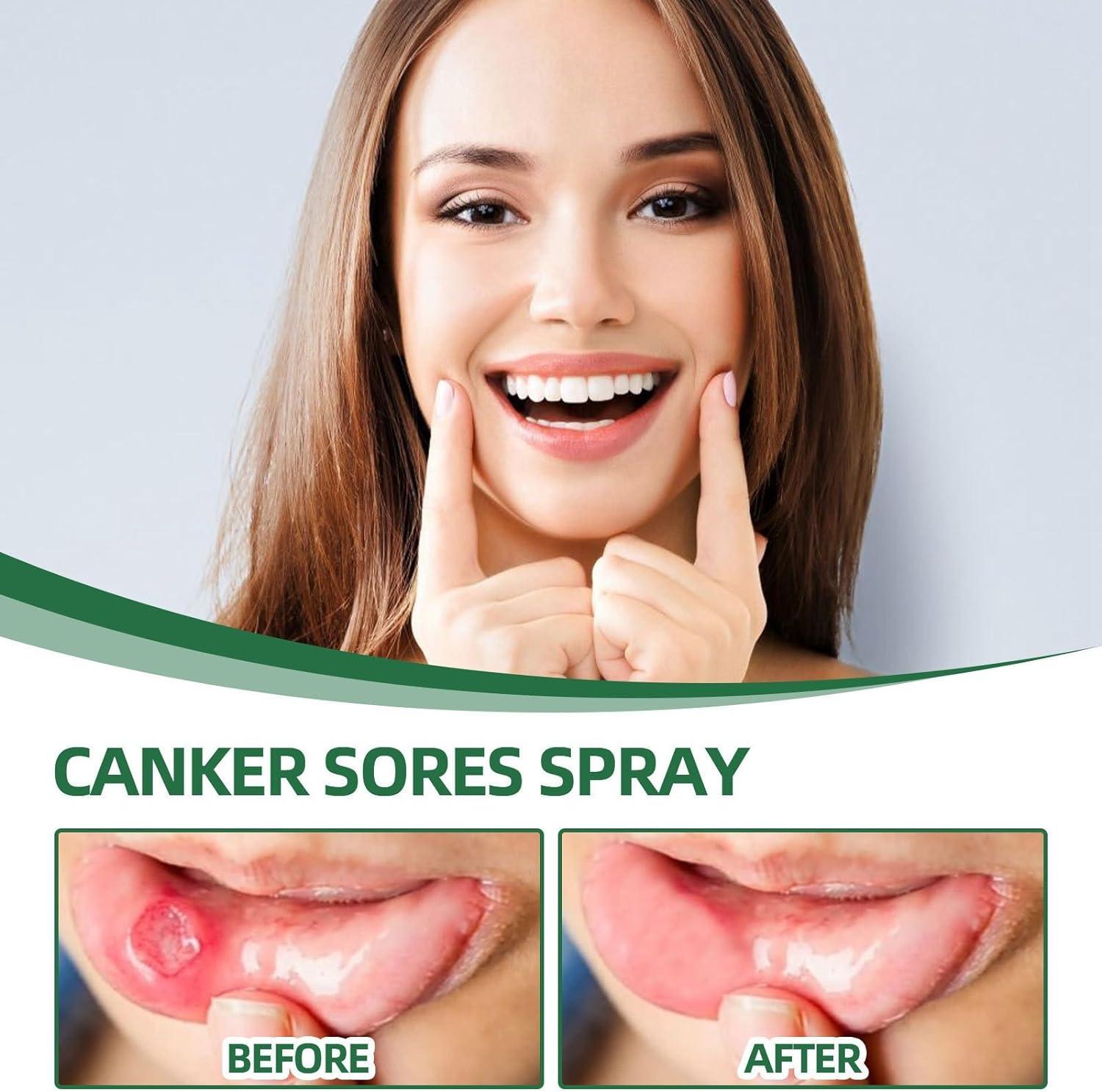 2pcs Mouth Ulcer Spray Mouth Ulcer Treatment Spray Canker Relief Spray ...