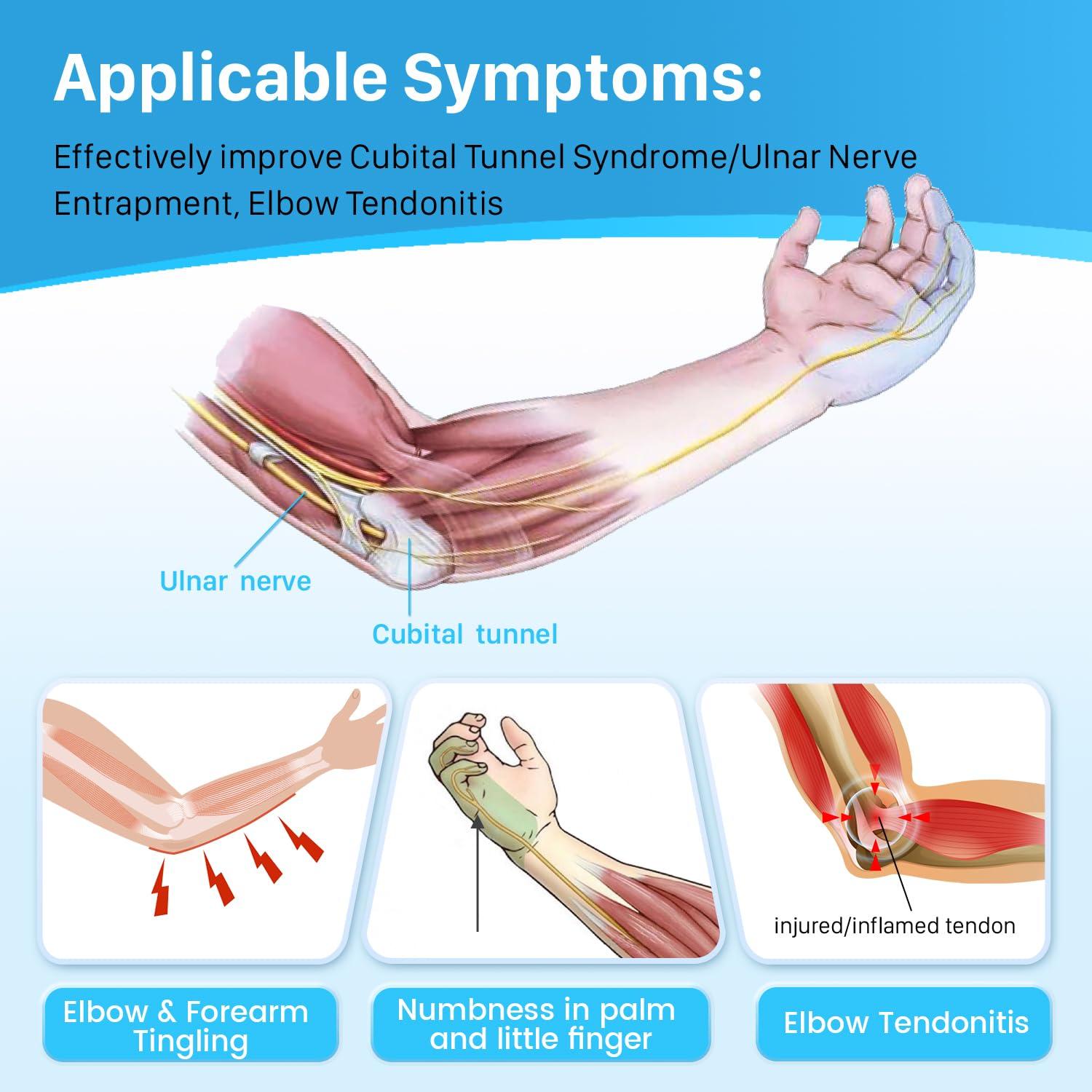 Ellenbow Rail for Cubital Tunnel Syndrome | Ulnar Nerve Elbow Support ...