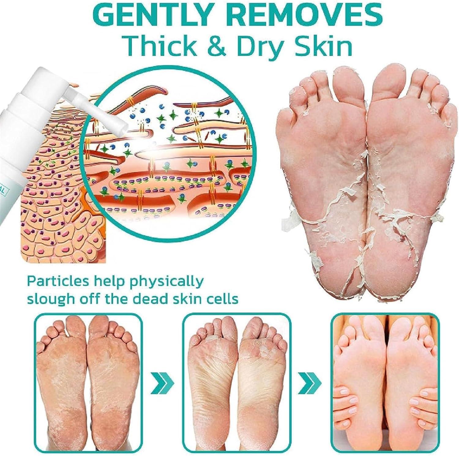 Professional Callus Remover Extra Strength Spray Foot Callus Removal ...