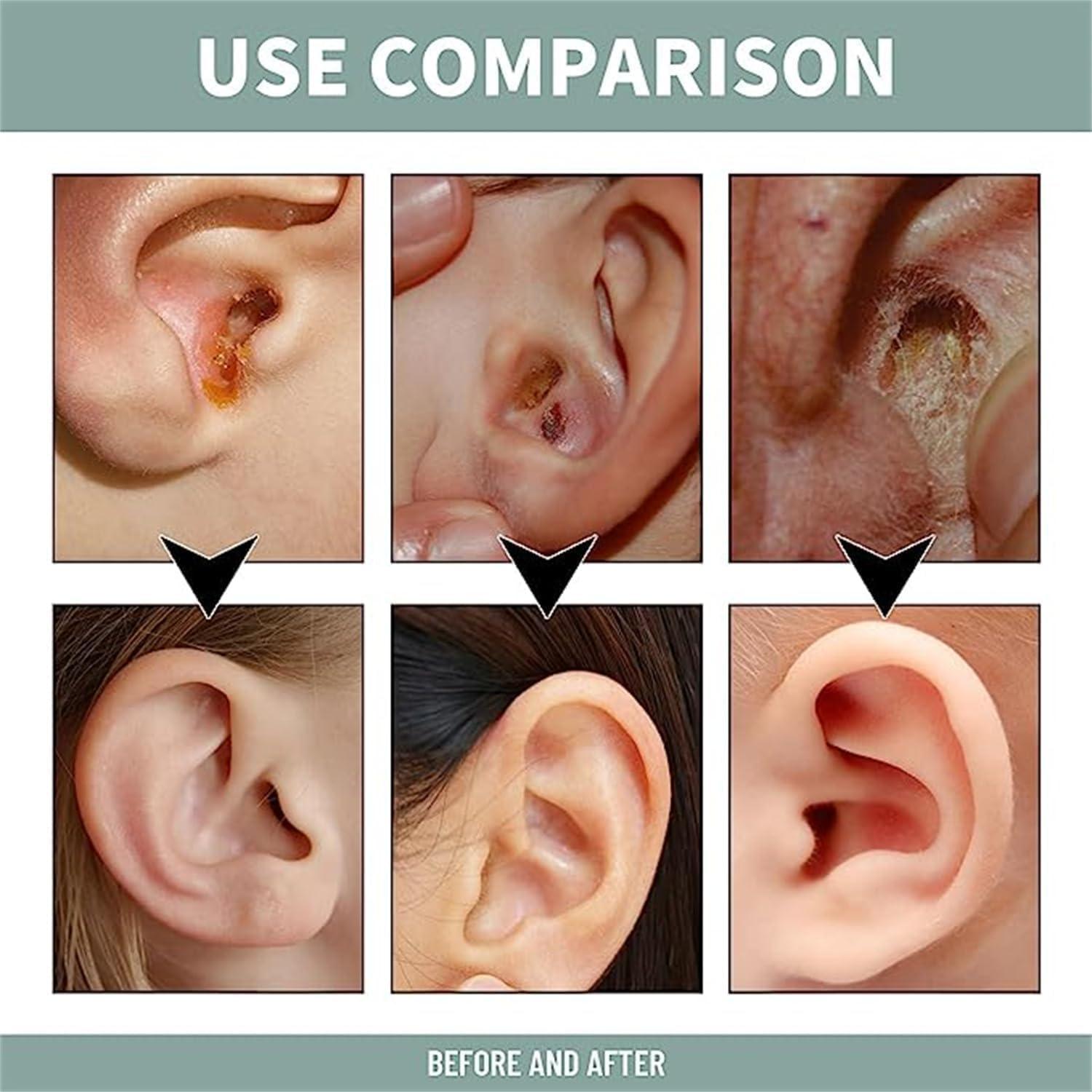 EXQST Anti-Tinnitus & Earwax Removal Spray - Natural Cochlea Cleaner ...