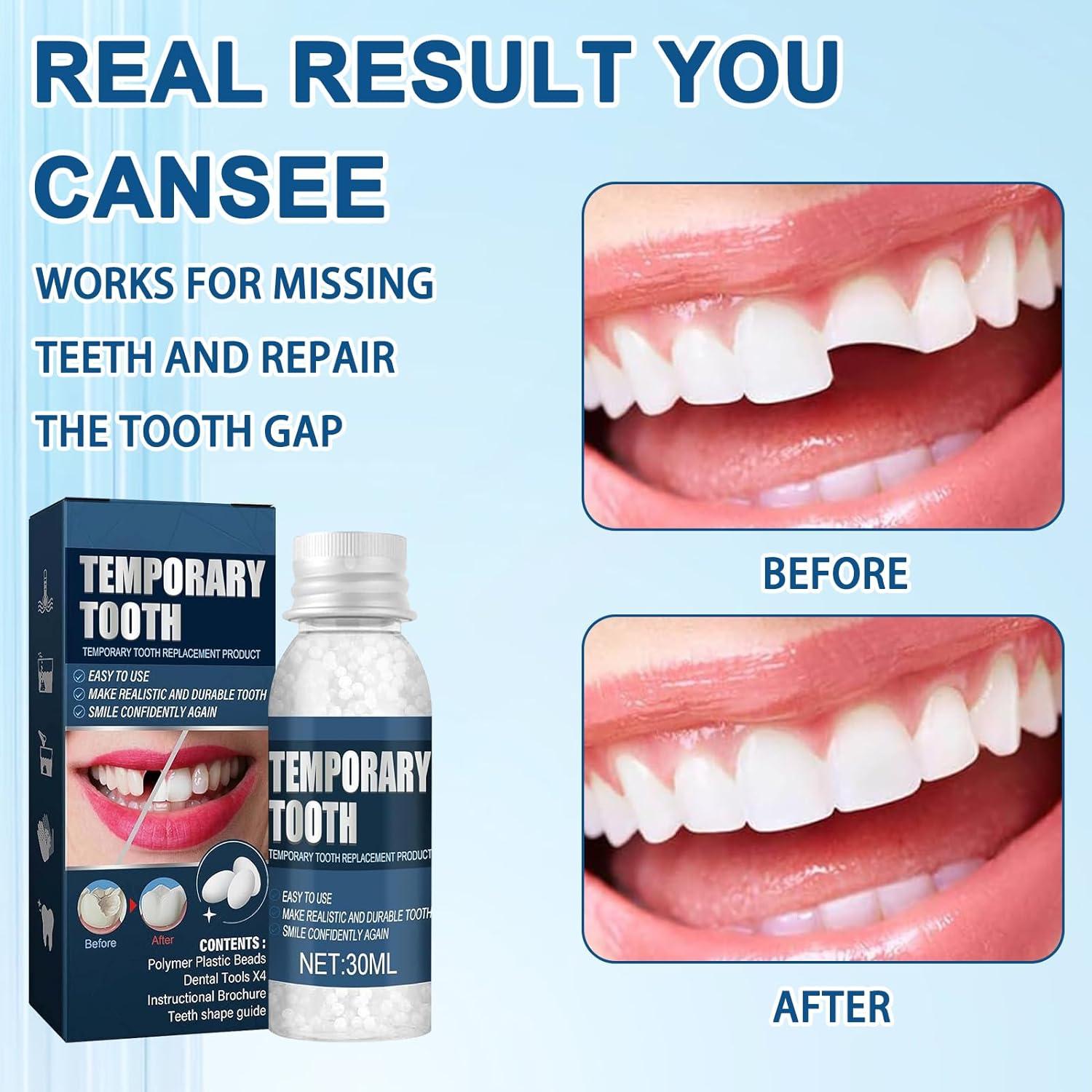 Tooth Filling Repair Kit Temporary Tooth Filling Repair Broken Teeth ...