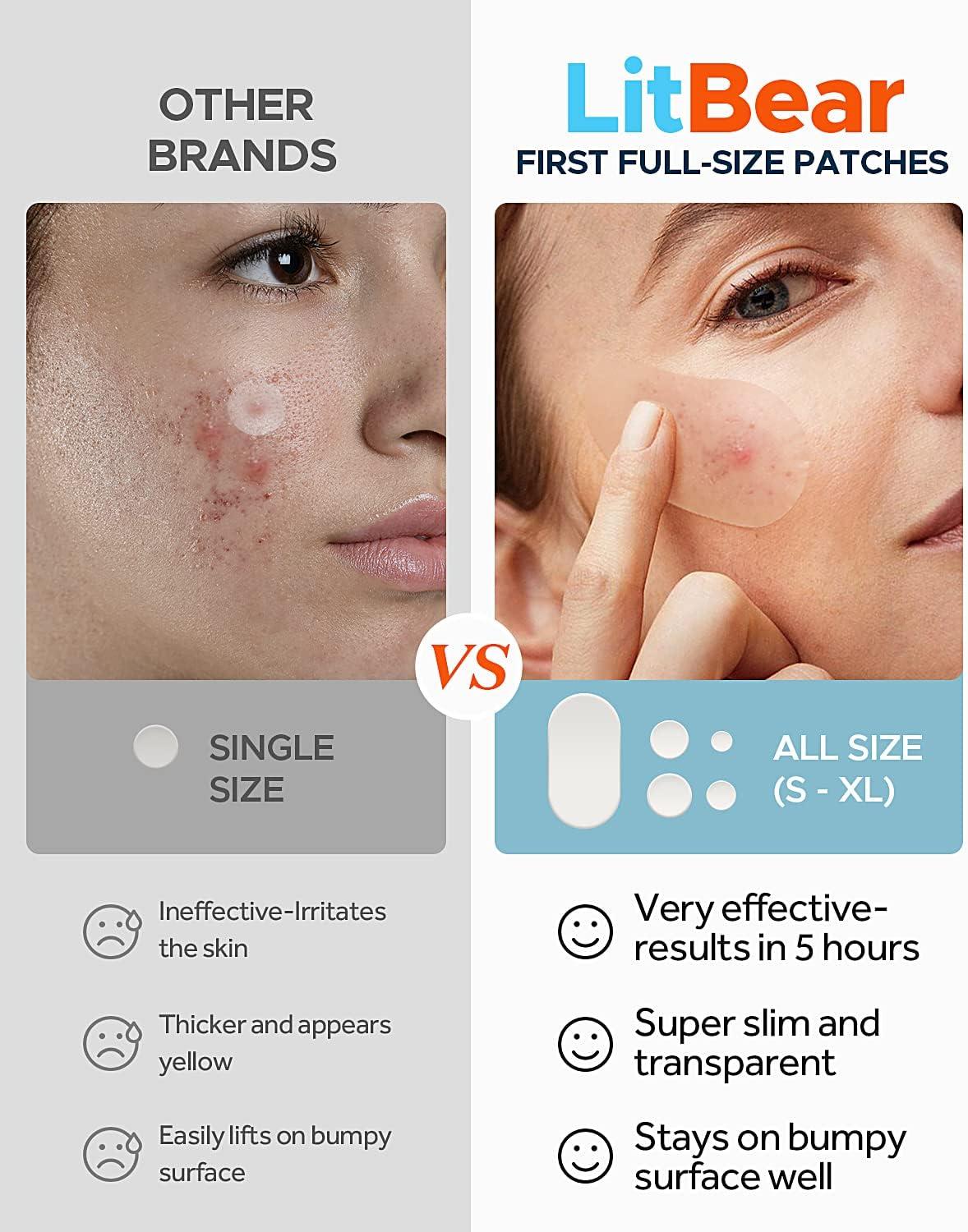 LitBear Acne Pimple Spot Patches - 80 Count Hydrocolloid Treatment for ...