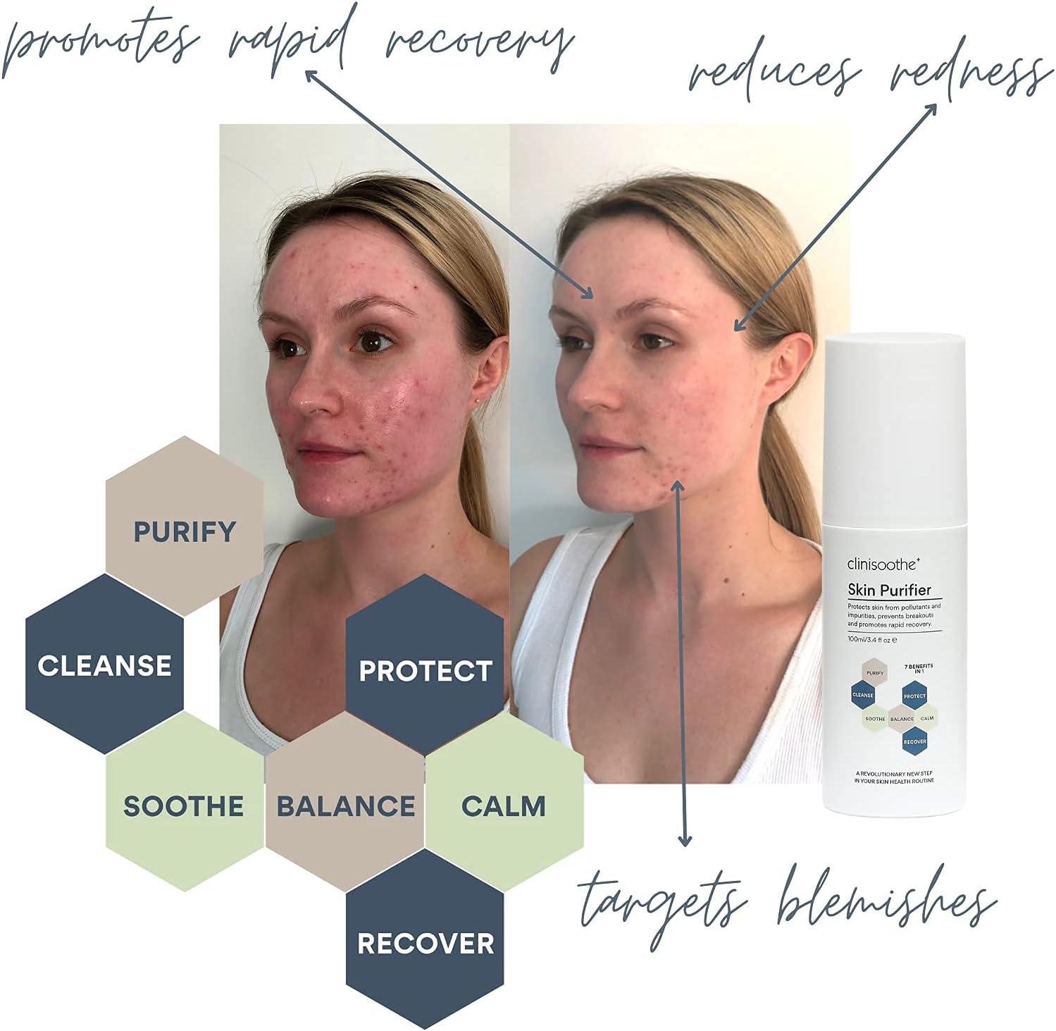 Clinisoothe+ Skin Purifier 100ml - Spot and Acne Treatment With ...