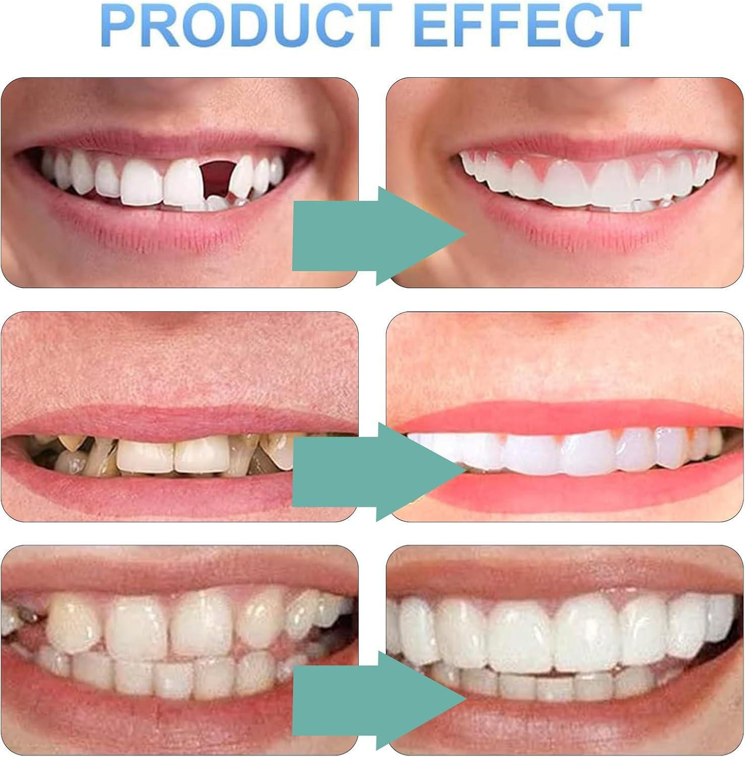 Instant Smile Makeover: Presses Fake Teeth Temporary Dentures ...