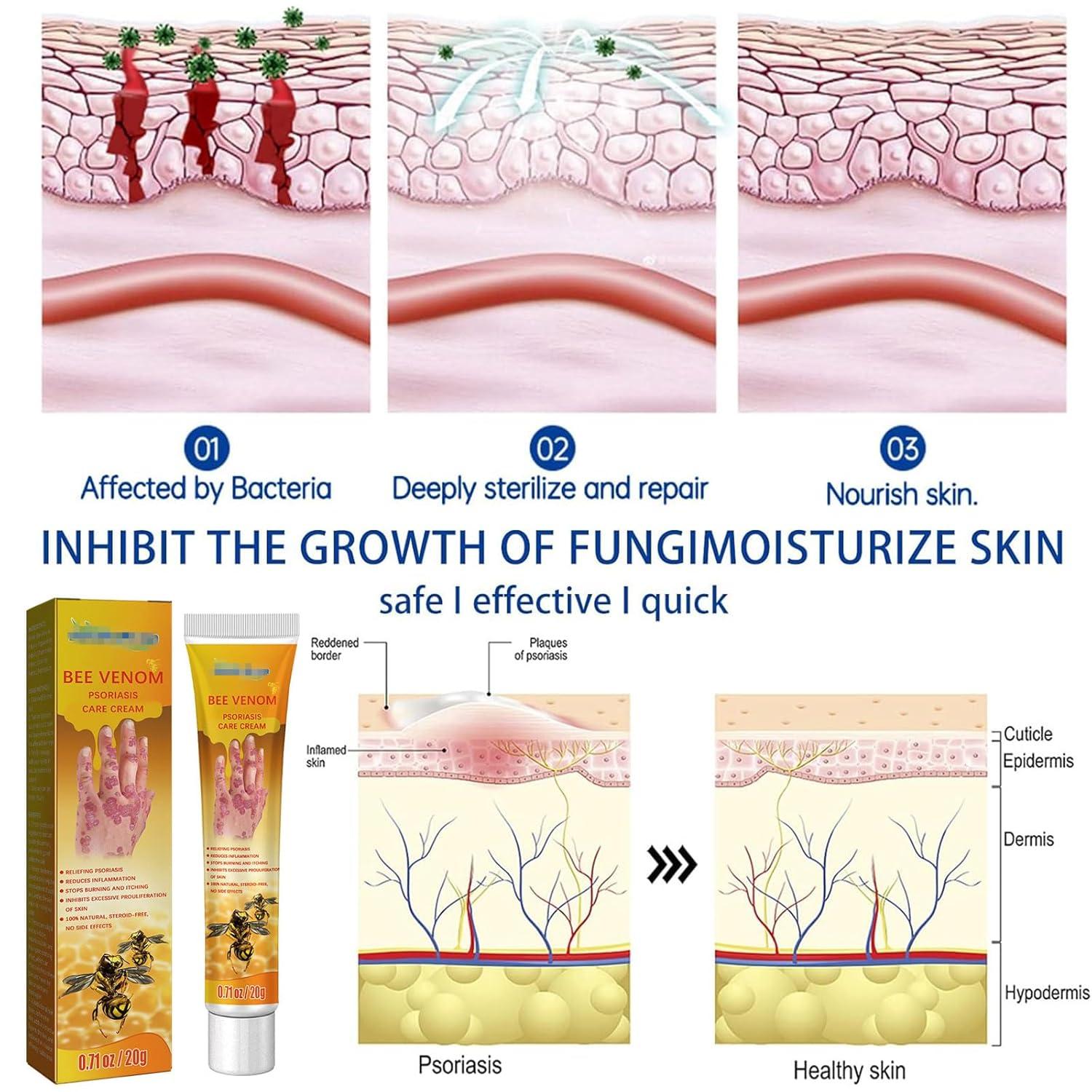 Beeergift Salbe Cream for Psoriasis | Professional Bee Venom Skin ...