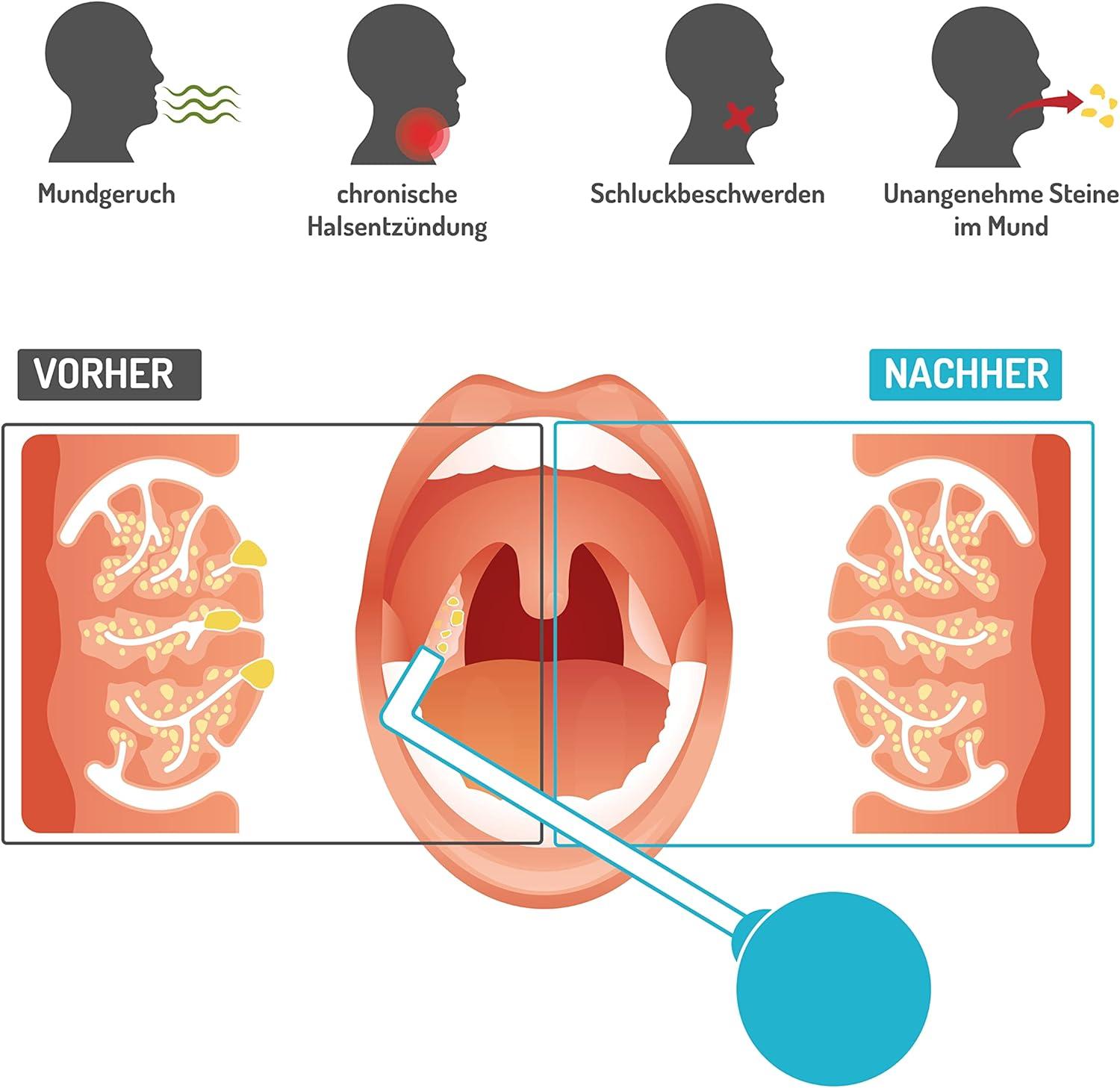 Fuchsia Tonsil Stones Remover | Effective Tonsil Suction Cup for Stone ...
