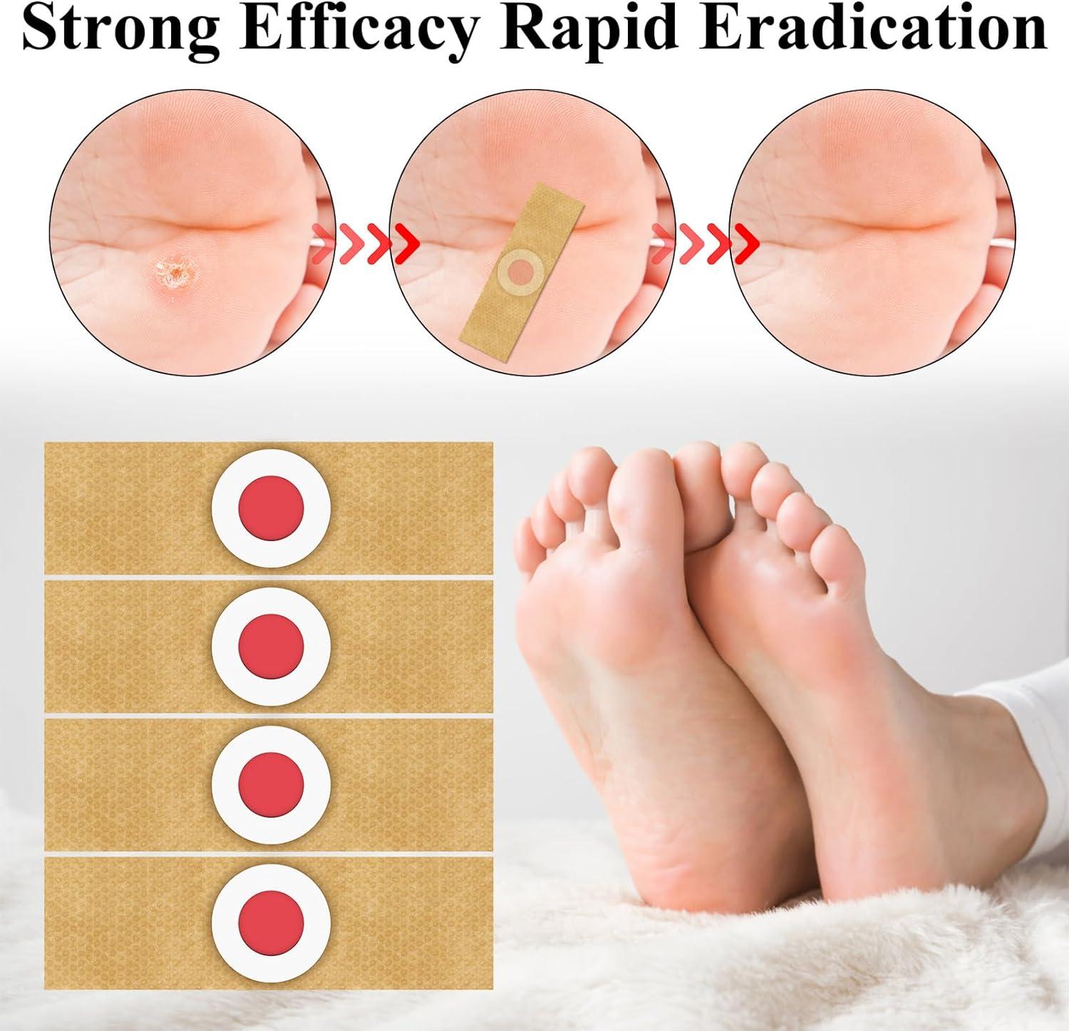 Beejoy 24pcs Wart Remover Pads for Painlessly Removing Common & Plantar ...