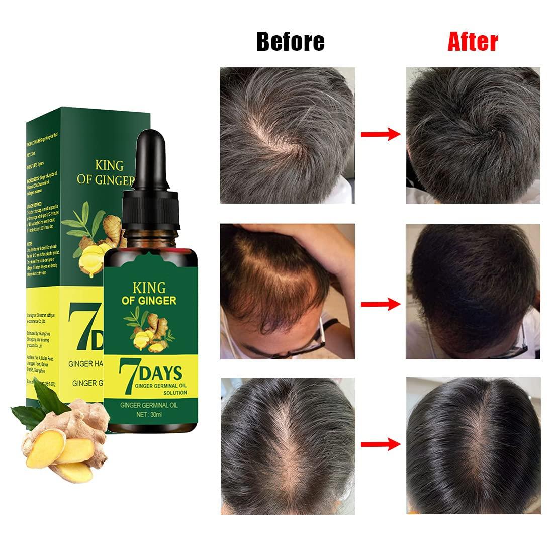 Ginger Hair Growth Germinal Oil 30ml 3pcs Regrow Hair In 7 Days