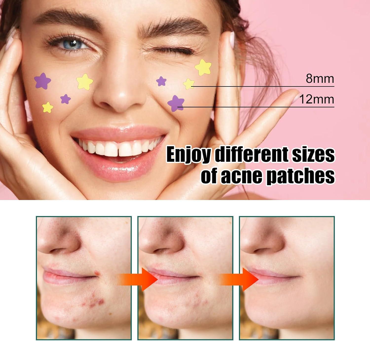 Pimple Patches Hydrocolloid Acne Patch for Face & Body | Calms ...