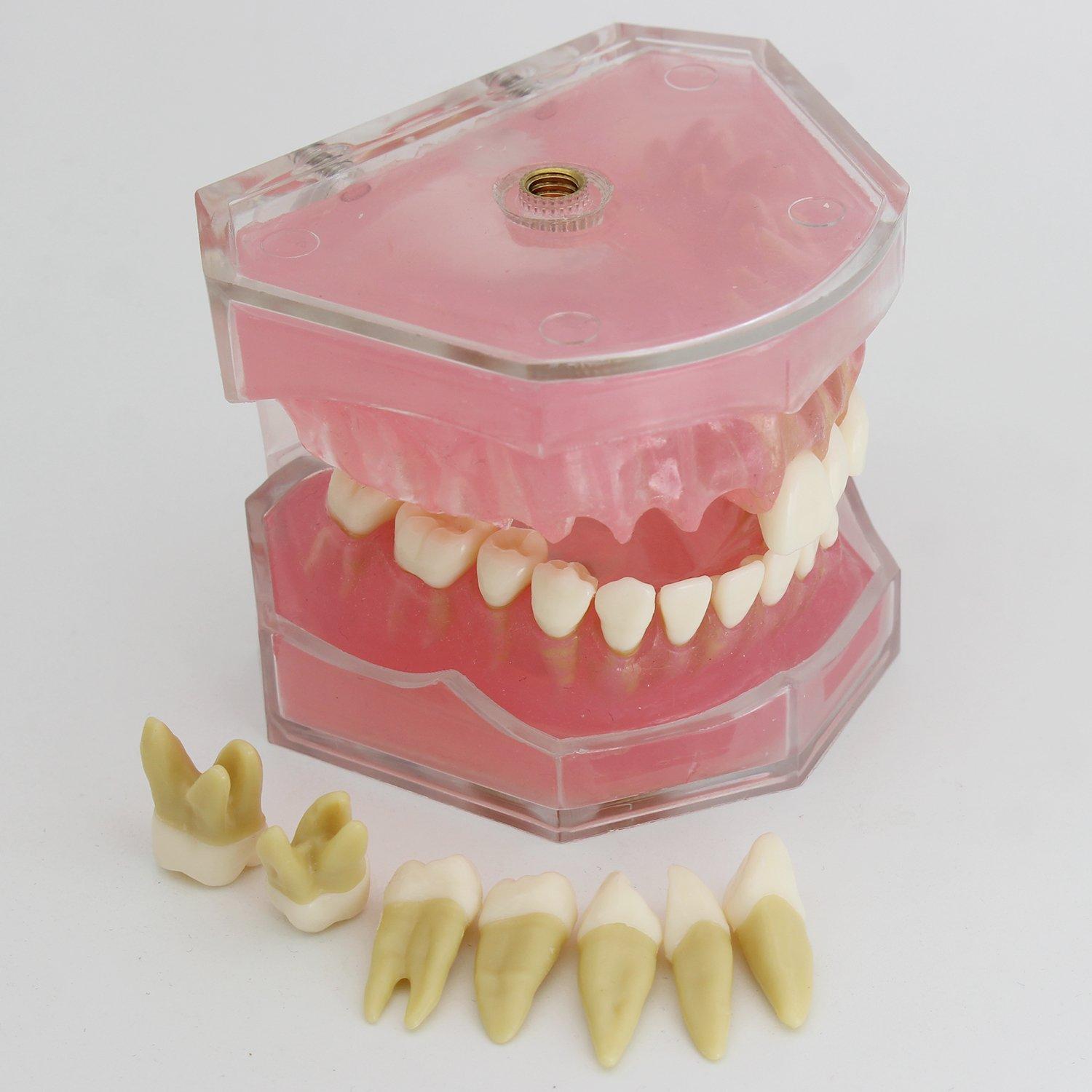 Dental Implant Teeth Model - Standard Study and Teaching Tool with ...