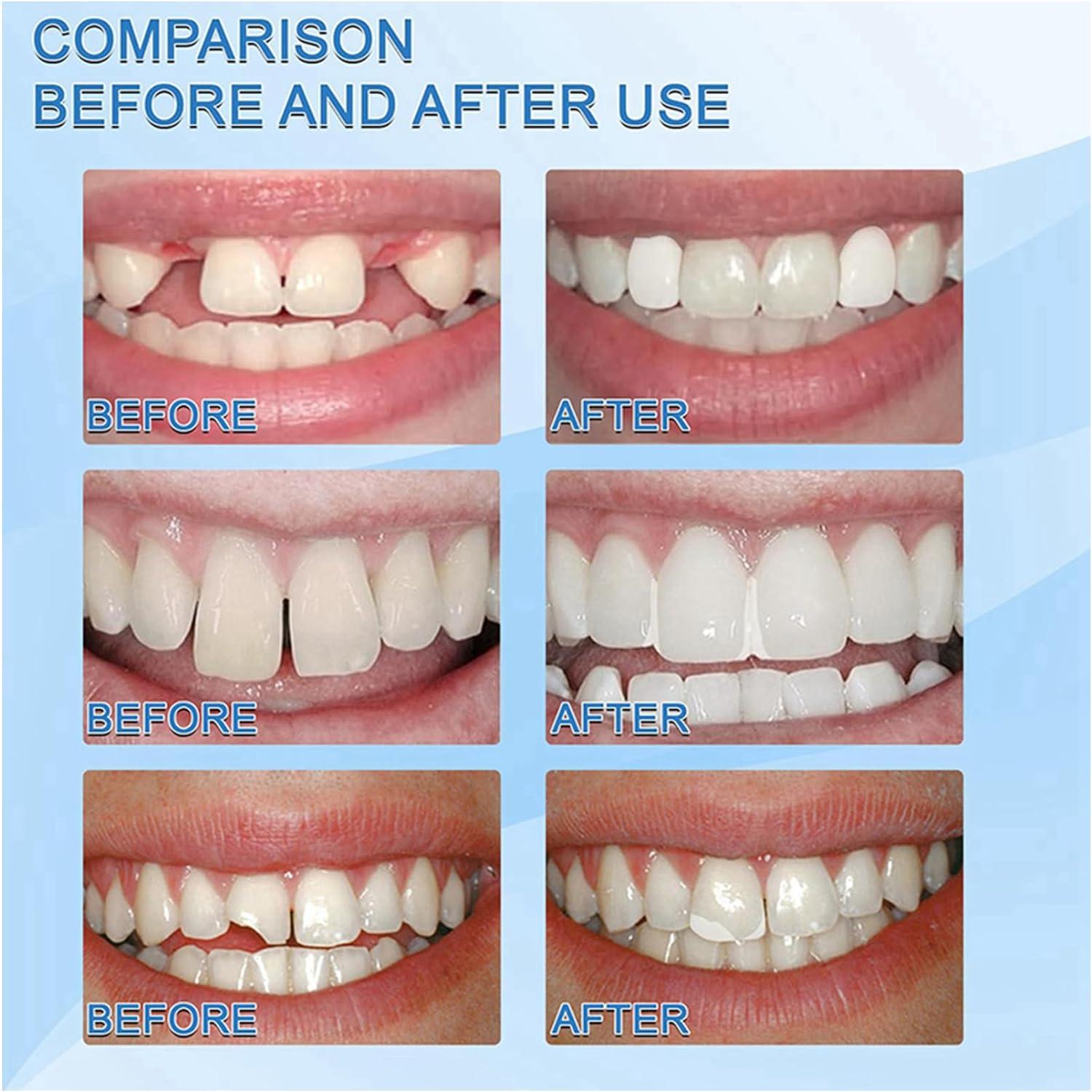 DIY Temporary Tooth Filling Kit for Missing or Broken Teeth - Moldable ...