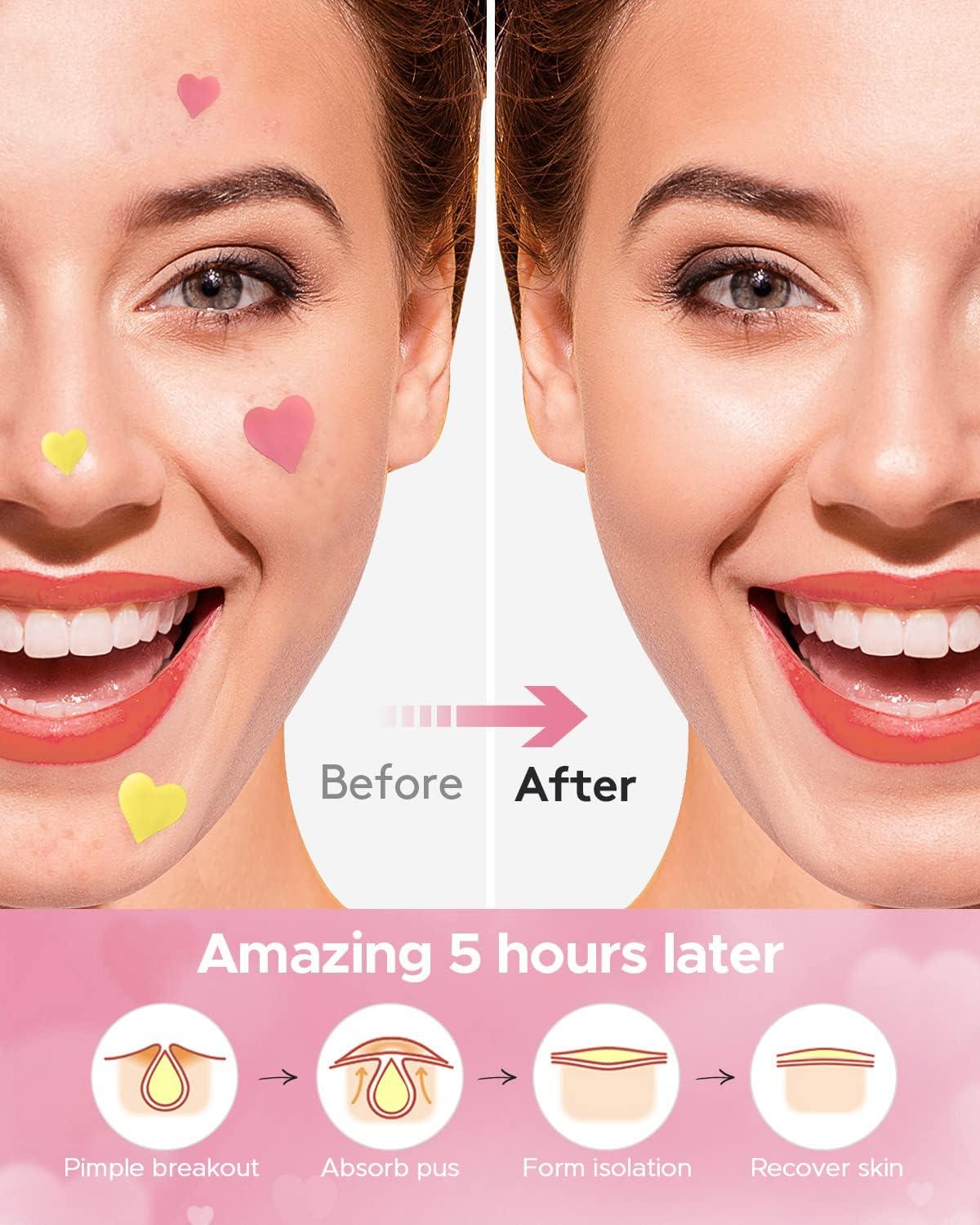 Pimple Patch Heart Shape 112 Hydrocolloid Acne Patches with Tea Tree ...