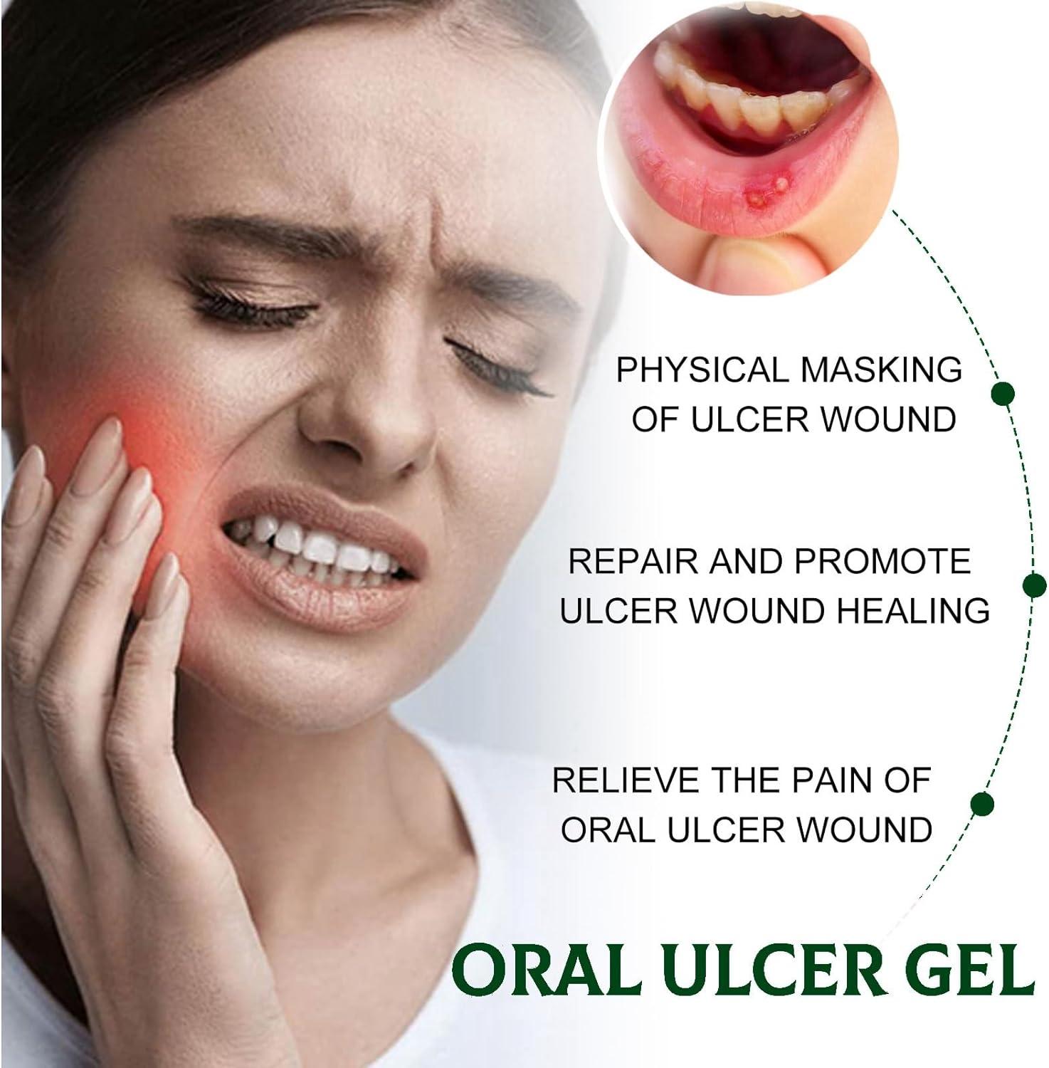 Ulcer Breath Sprays Mouth Ulcers Treatment Spray Ulcer Treatment Canker ...