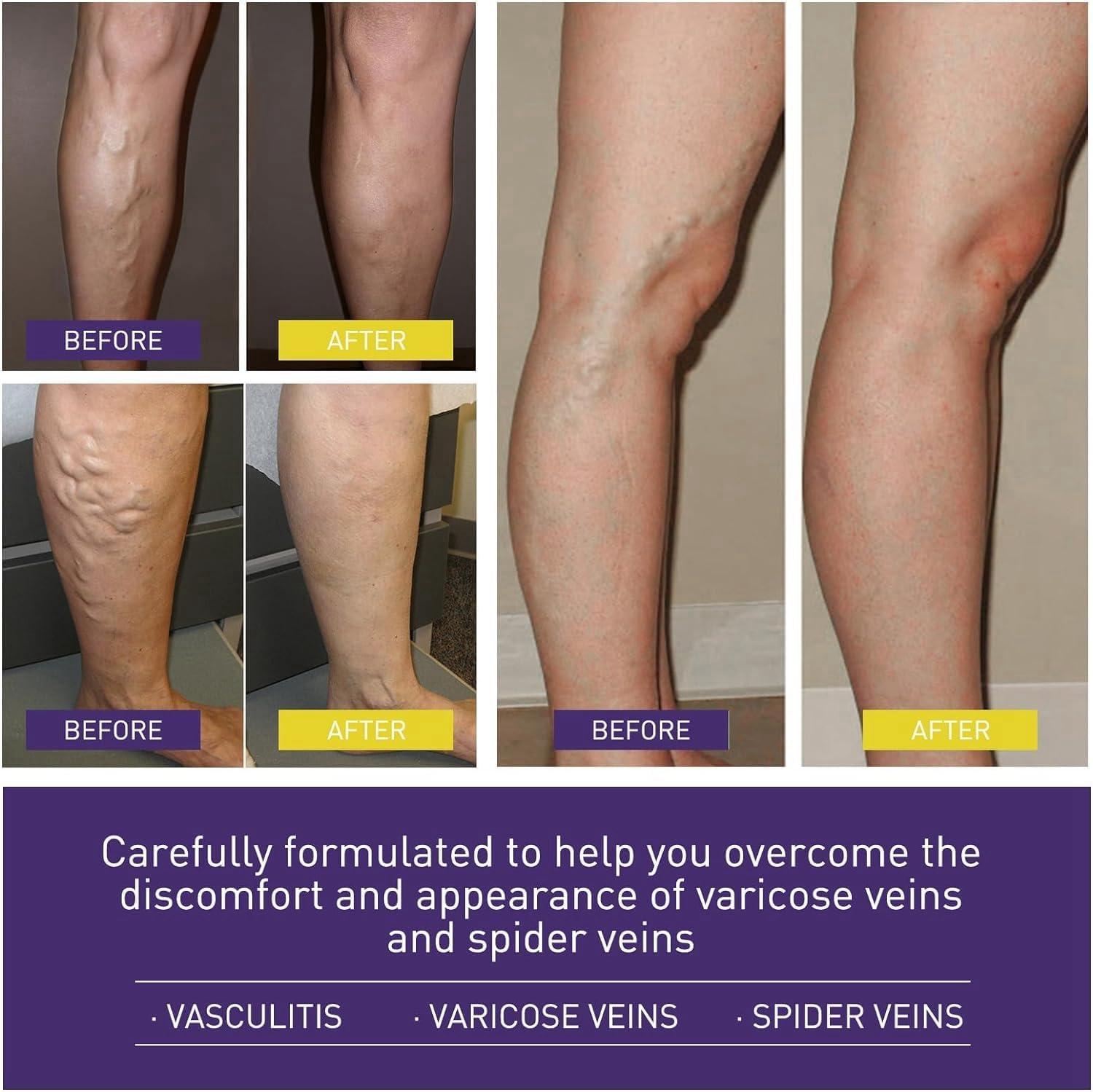 Varicose Veins Cream - Spider Veins Repair & Treatment for Legs ...