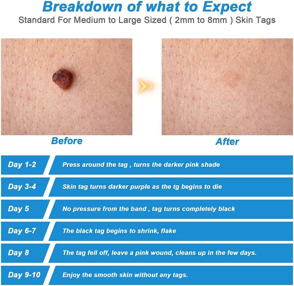 2-in-1 Skin Tag Remover - Painless Automatic Mole & Wart Removal + 40 ...