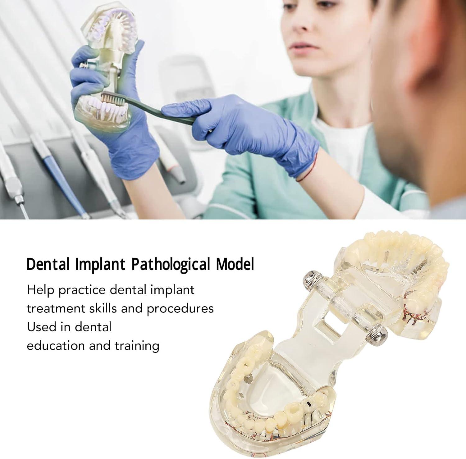 Buy Verdant Touch Pathological Implant Model - Transparent Dental ...