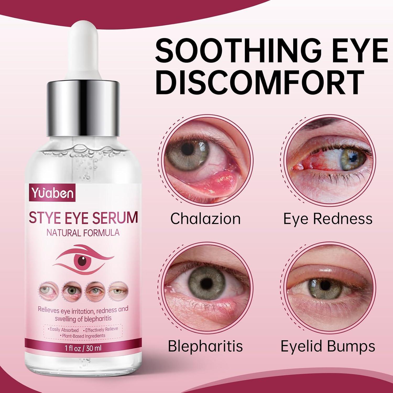 eye chalazion drops