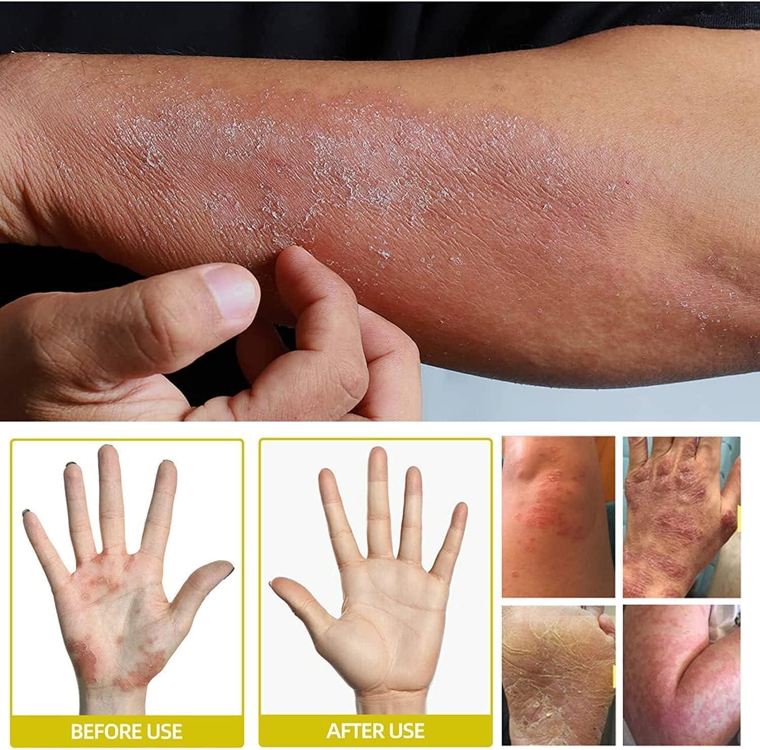 Endxedio Herbal Tinea Corporis Cream - Skin Relief & Anti-Itch Ointment ...