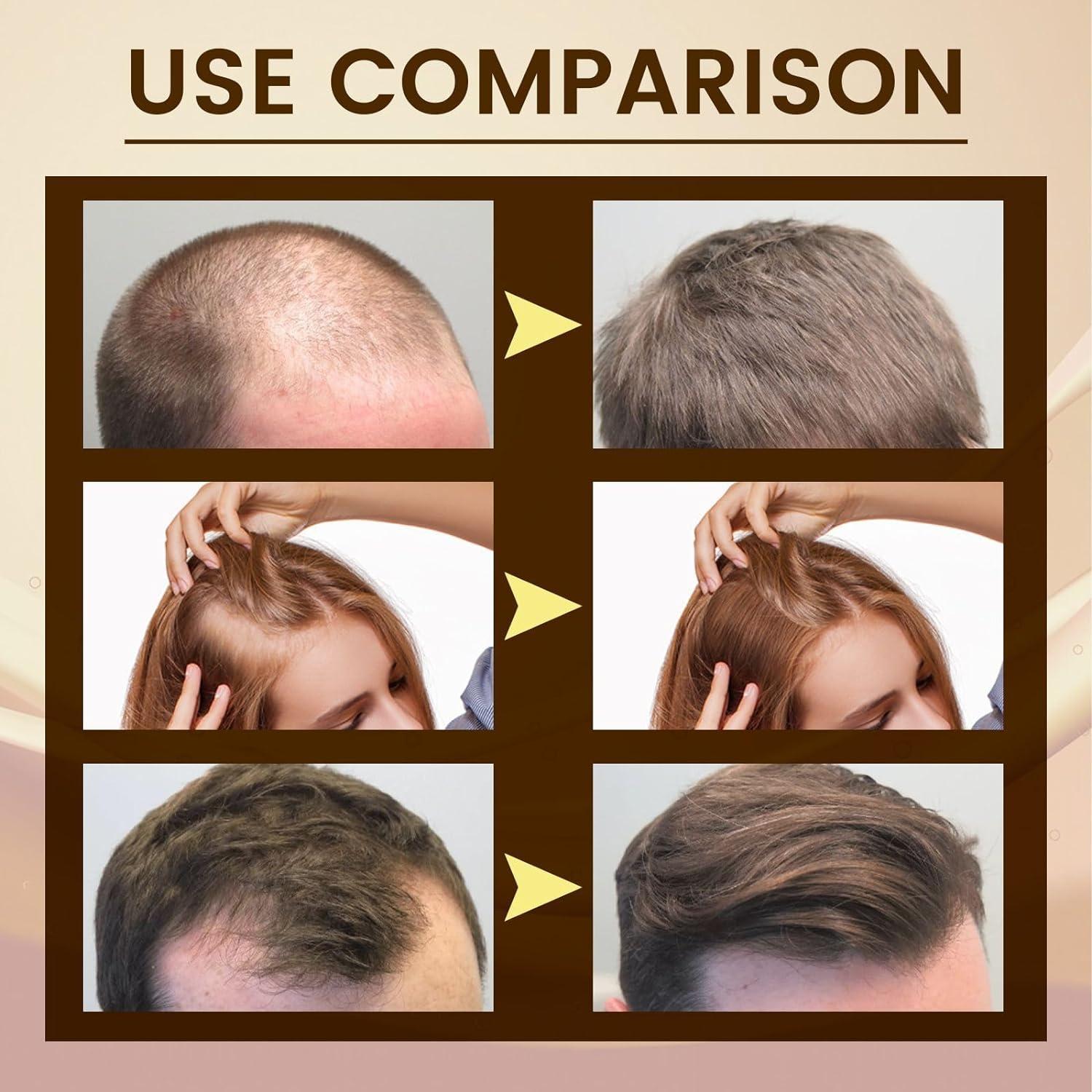 5% Biotin Minoxidil Hair Growth Oil 5% Minoxidil for Men and Women Hair ... 5% Biotin Minoxidil Hair Growth Oil 5% Minoxidil for Men and Women Hair ...