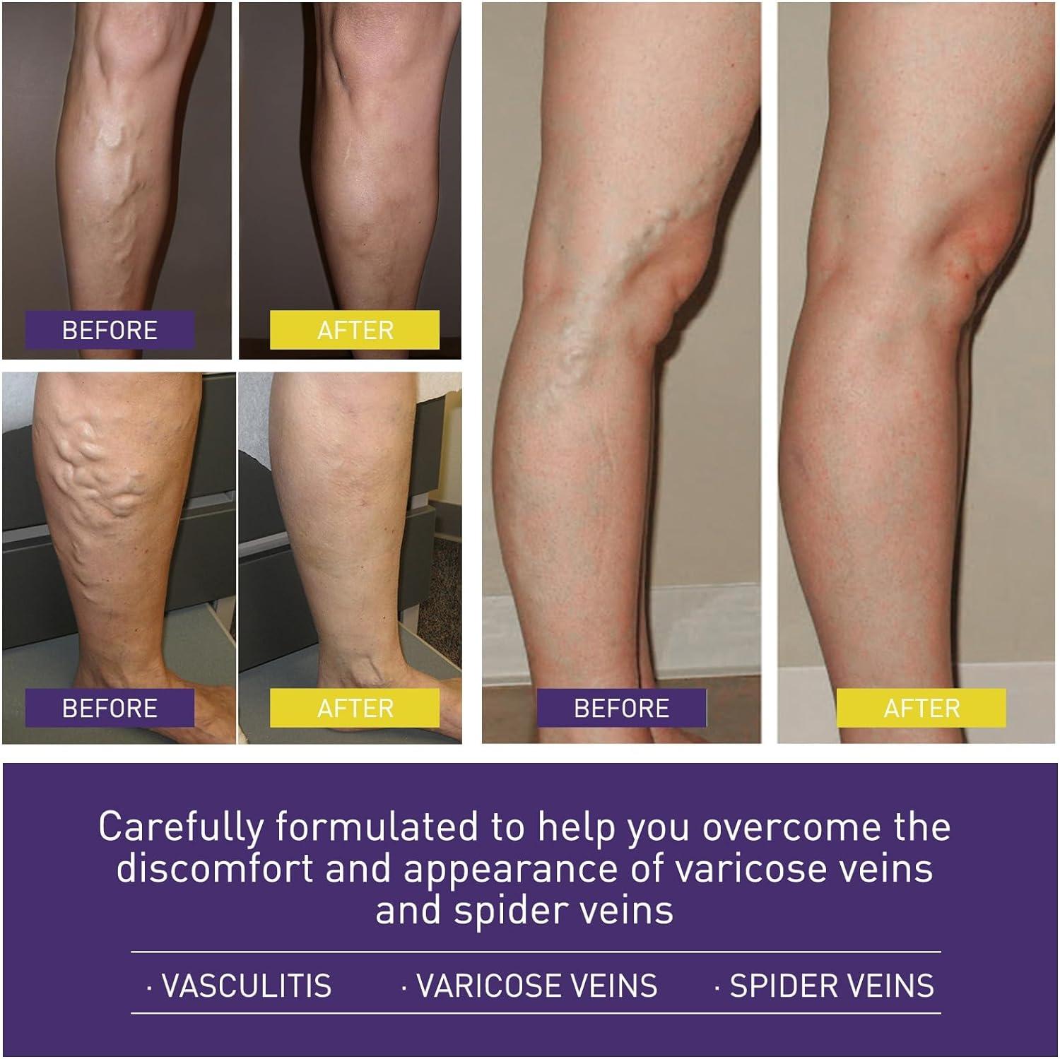 Varicose Veins Cream Spider Vein Cream Varicose Veins Treatment for ...