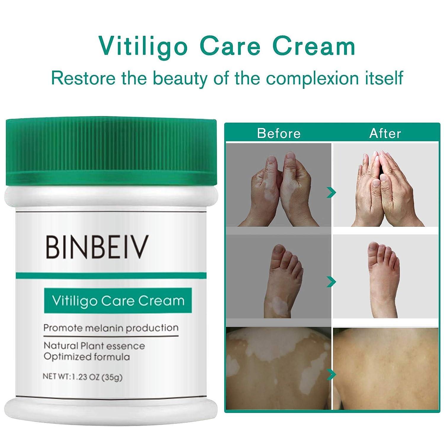 BINBEIV Vitiligo Care Cream - Pigmentation Regulating Formula | Fade ...