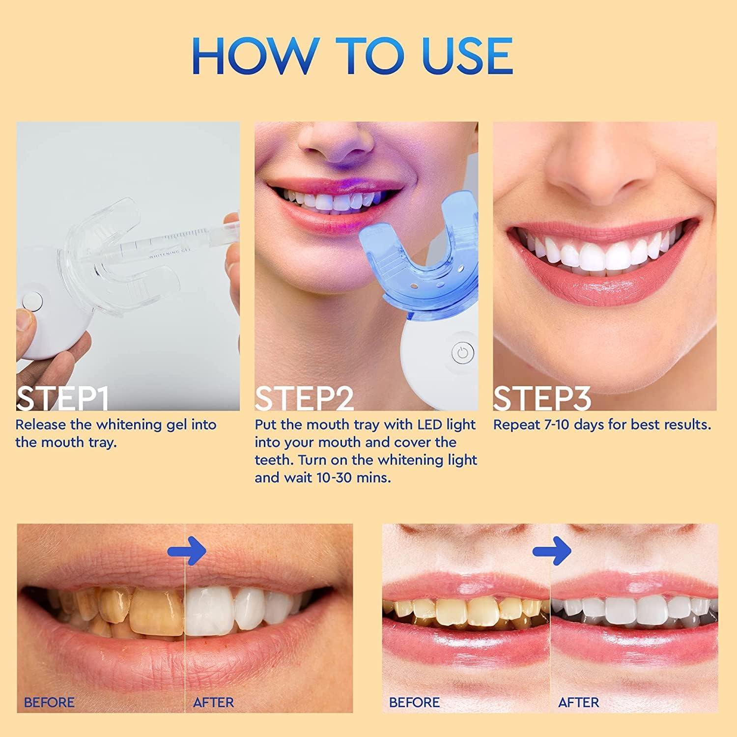 Teeth Whitening Kit at Home Whitening System - with a 5X LED Light 1 ...