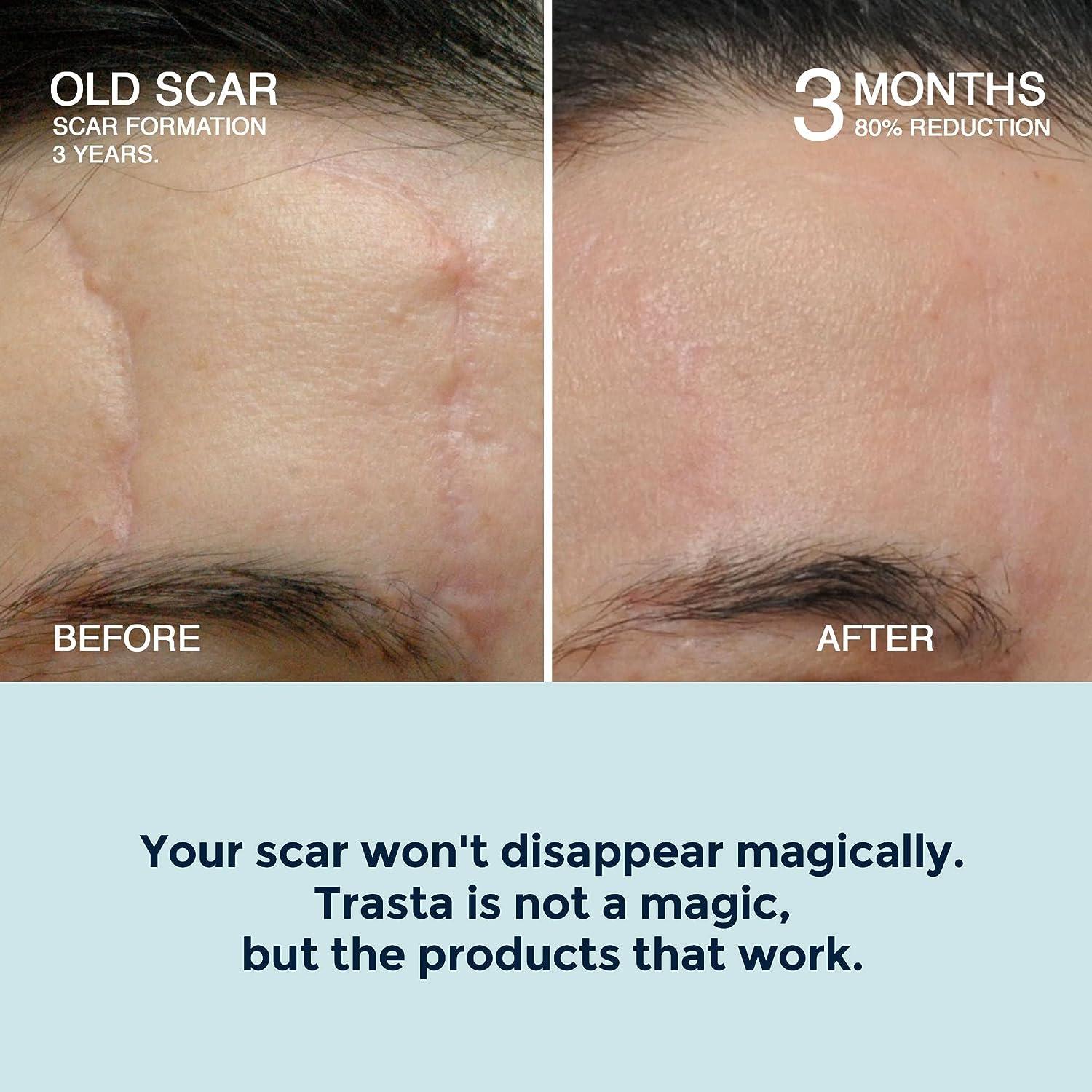 TRASTA MEDICA Scar Removal Cream - All Natural Anti Scar Treatment for ...