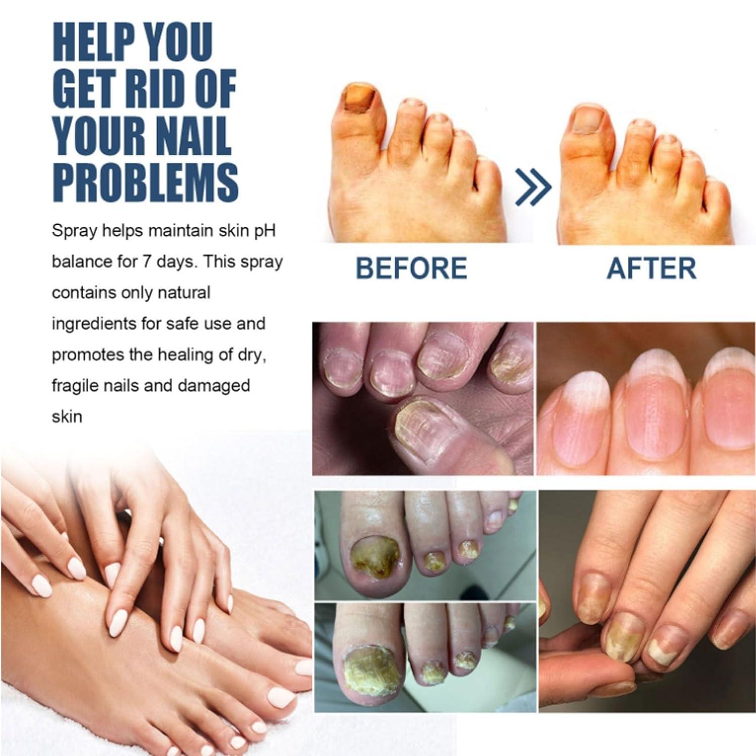 Furzero Nail Fungus & Athlete's Foot Treatment Spray - Medical Grade ...