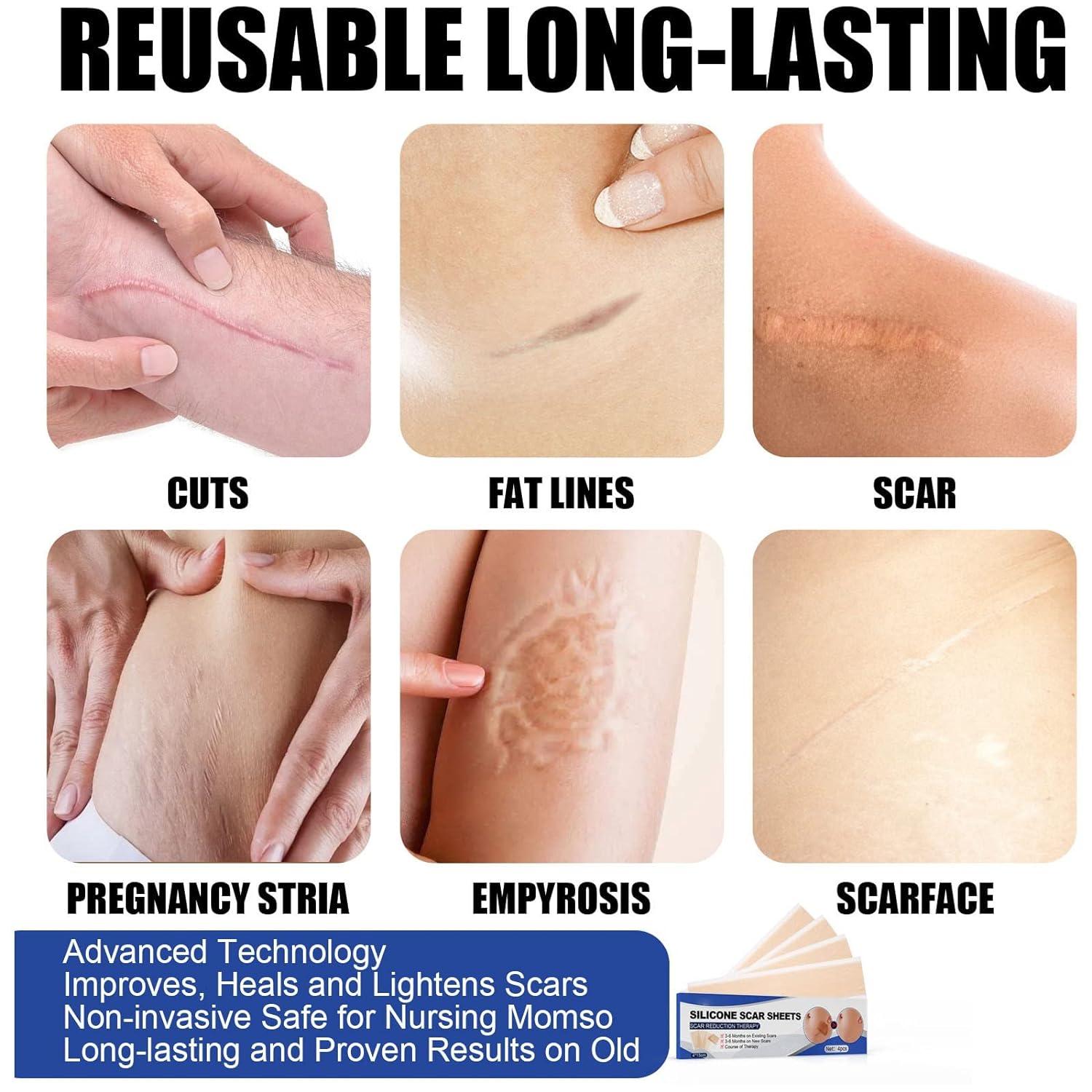 Silicone Gel Scar Patch for Firming Eyelids, Fading Stretch Marks ...