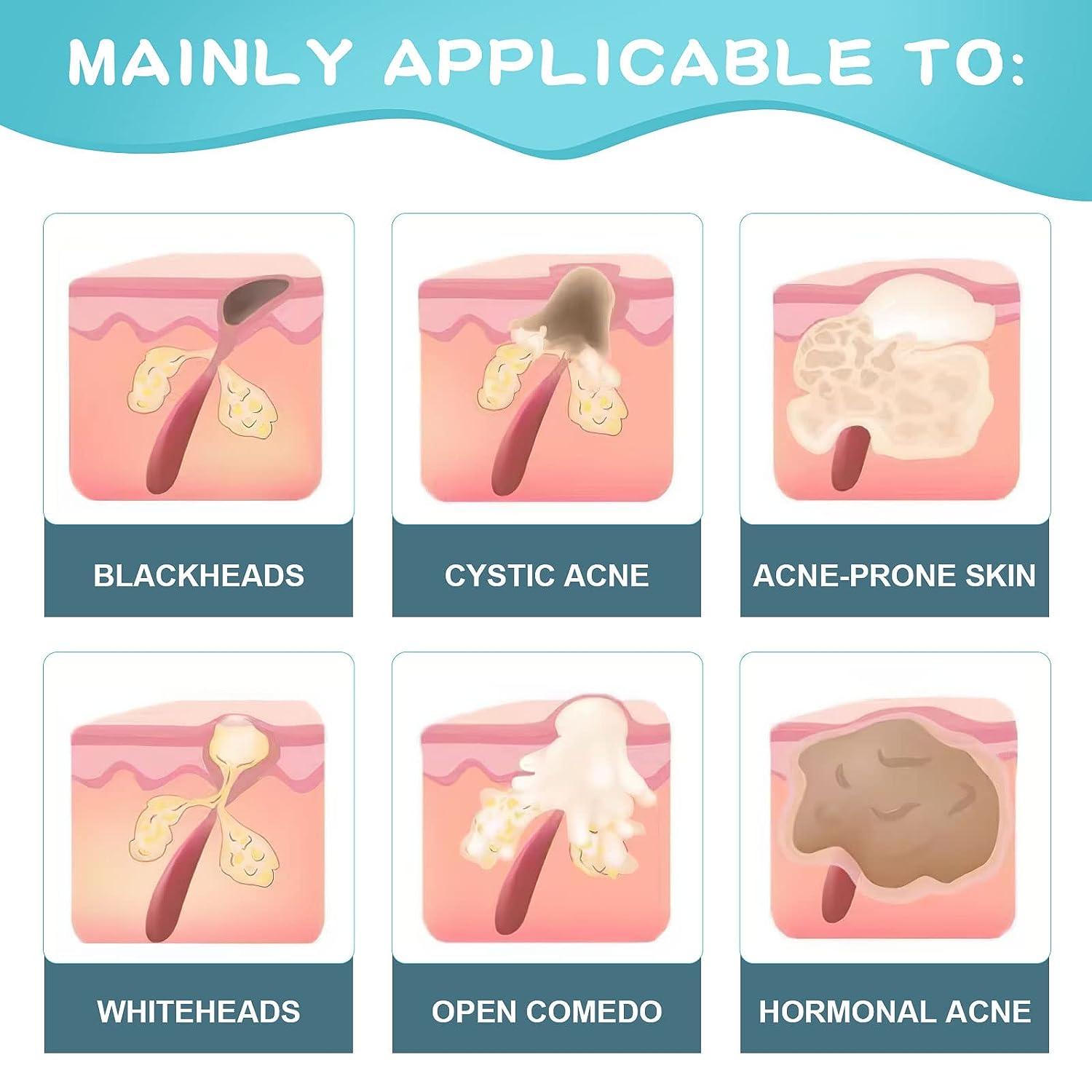 Paradise Emerald Cystic Acne Spot Treatment with Salicylic Acid and Tea ...