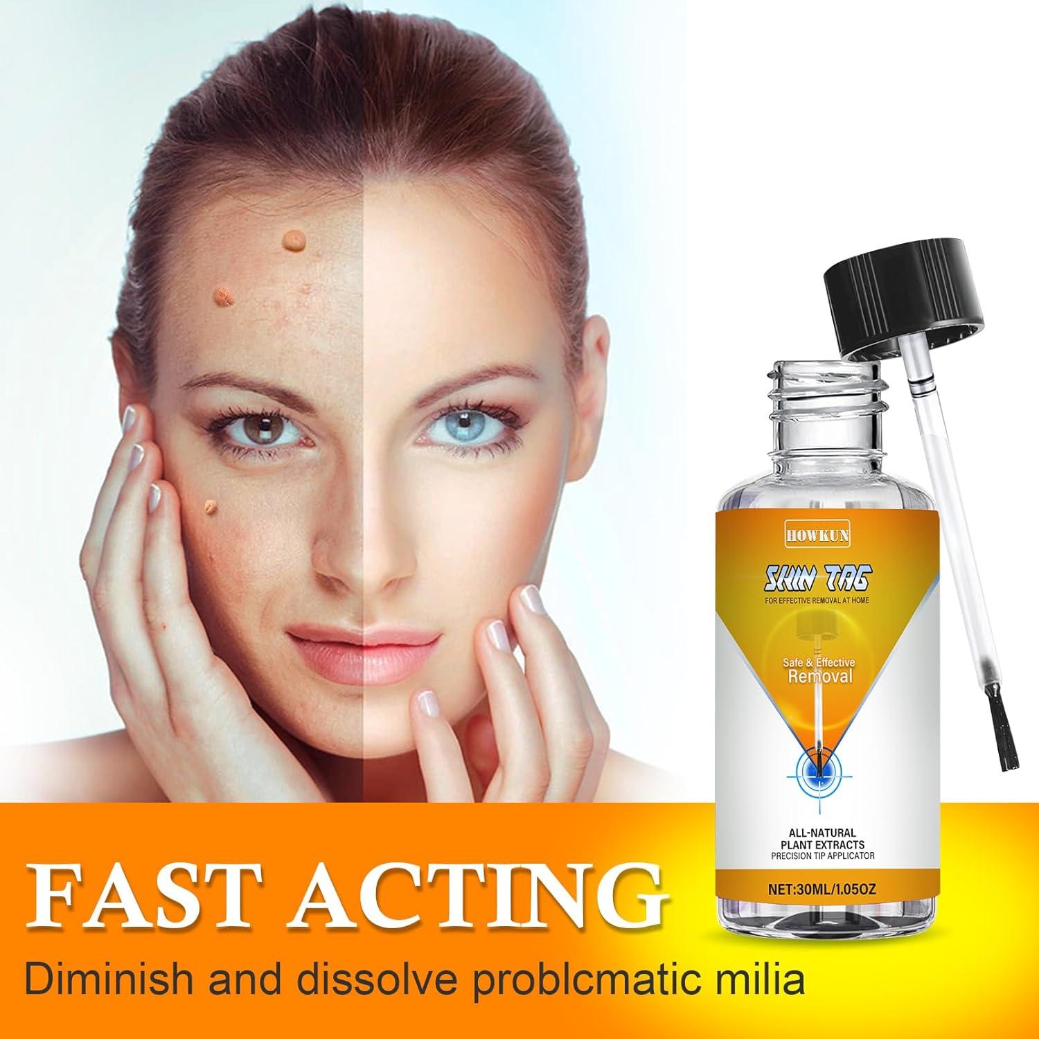 Skin Tag Removal and Wart/Mole Remover Lotion - Fast-Acting Blue ...