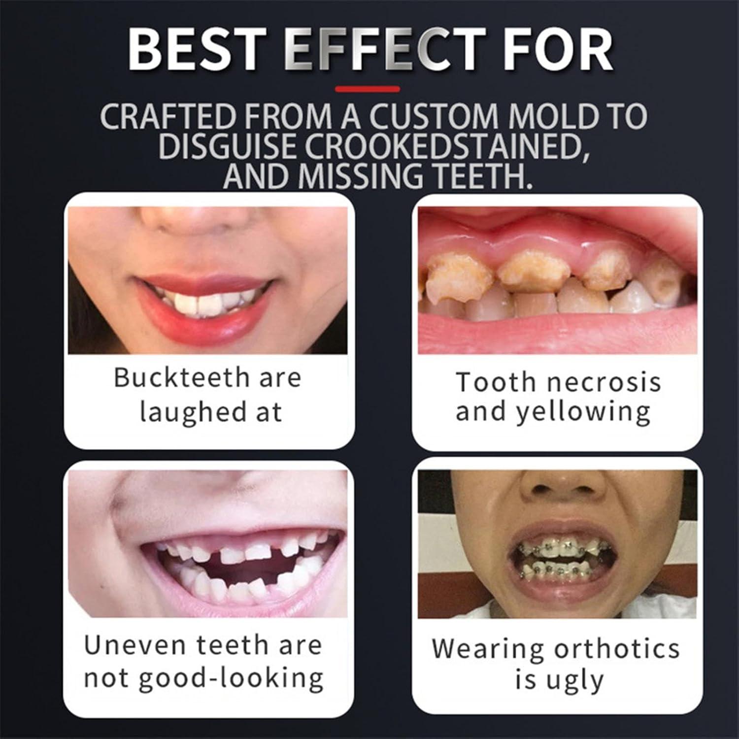 Floapa Smile Teeth Veneers - Temporary Teeth Braces for Confident Smile ...