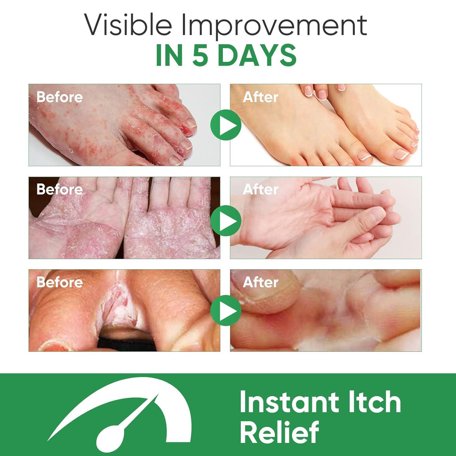 Natural Anti-Fungal Foot Spray for Athlete's Foot Treatment - Relieves ...