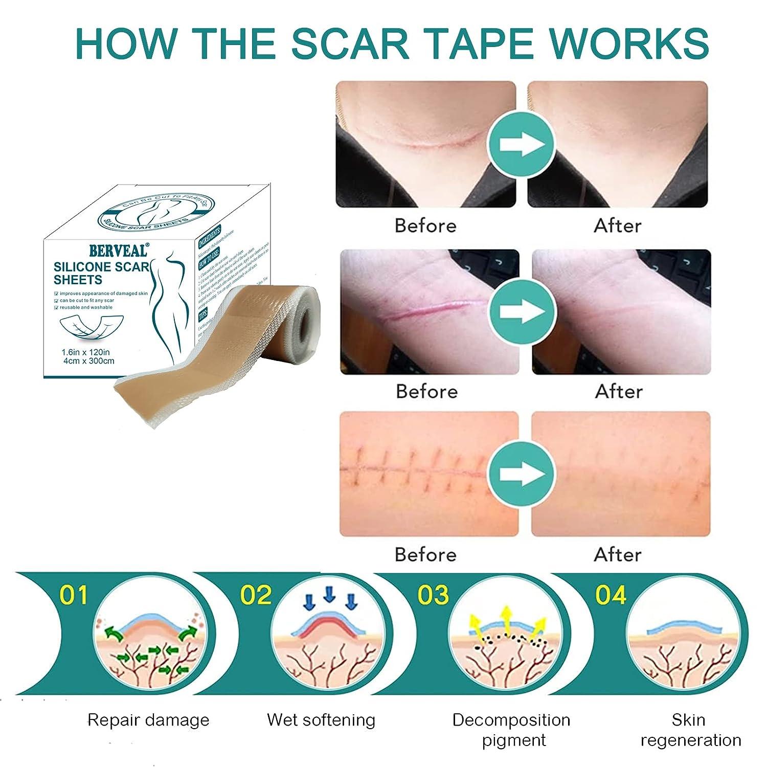 Silicone Scar Tape Roll - Easy-Tear Gel Tape for Surgery Scars - 1.6 x ...