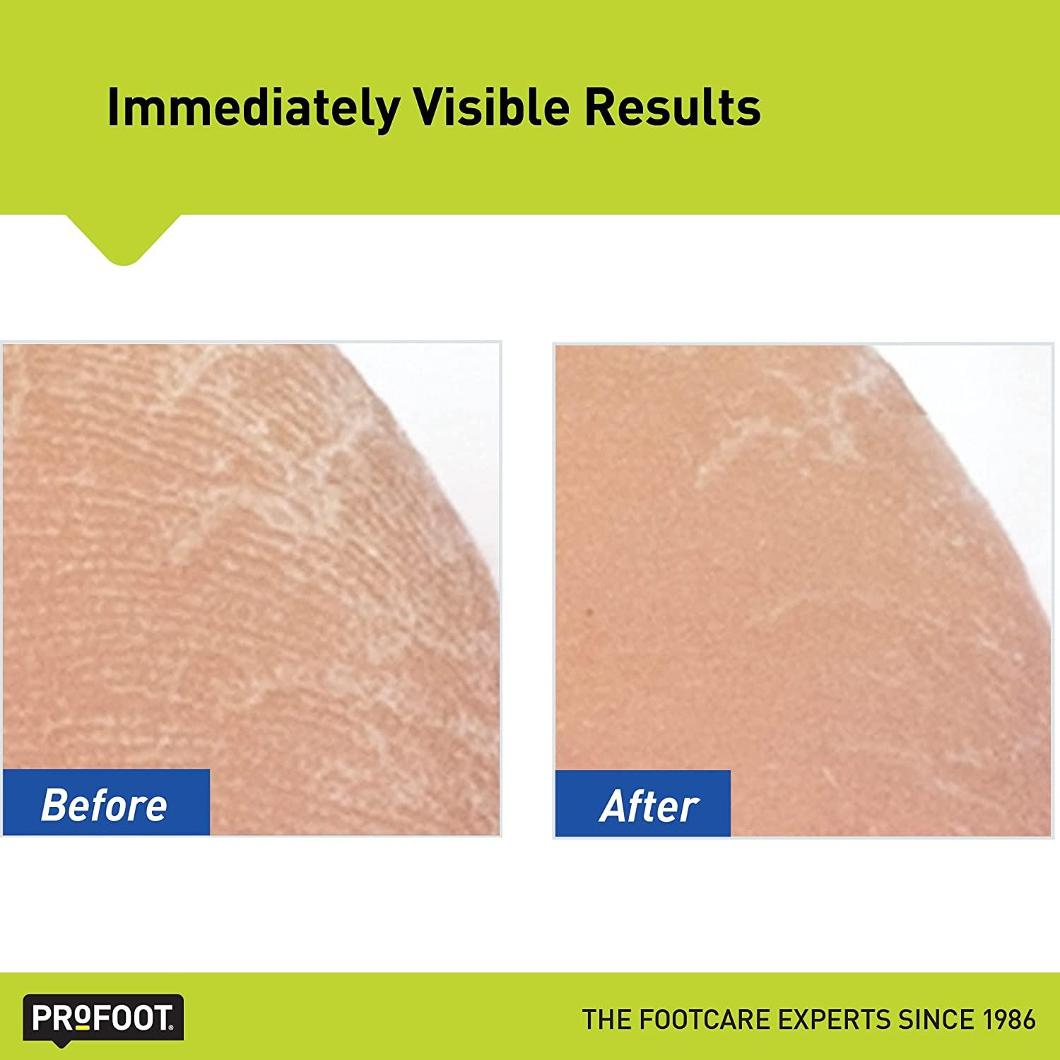 Profoot Heel Rescue Foot Cream 16oz Bottle - 2 Pack for Cracked ...