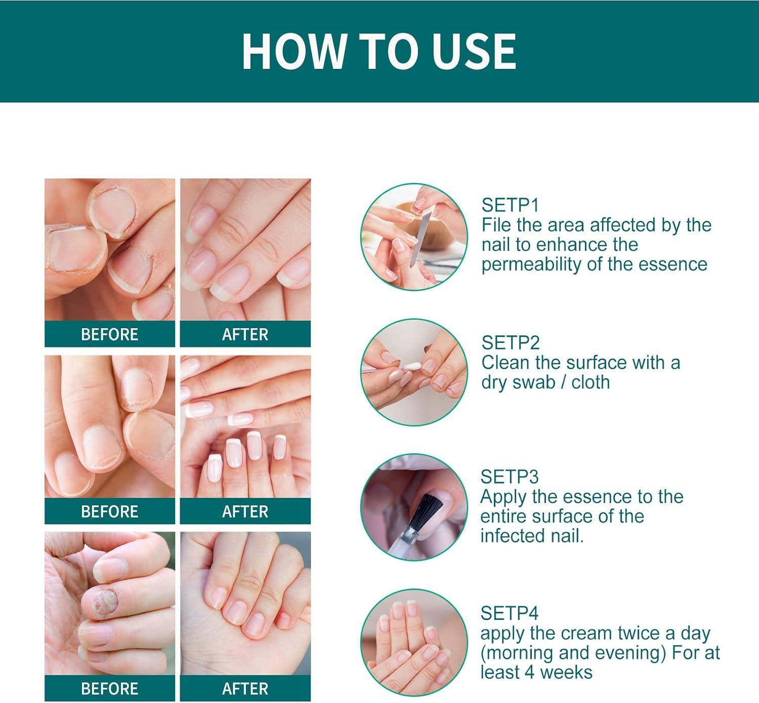 Nail Fungus Treatment for Toenail Nail Repair Kit with Glass Nail File ...