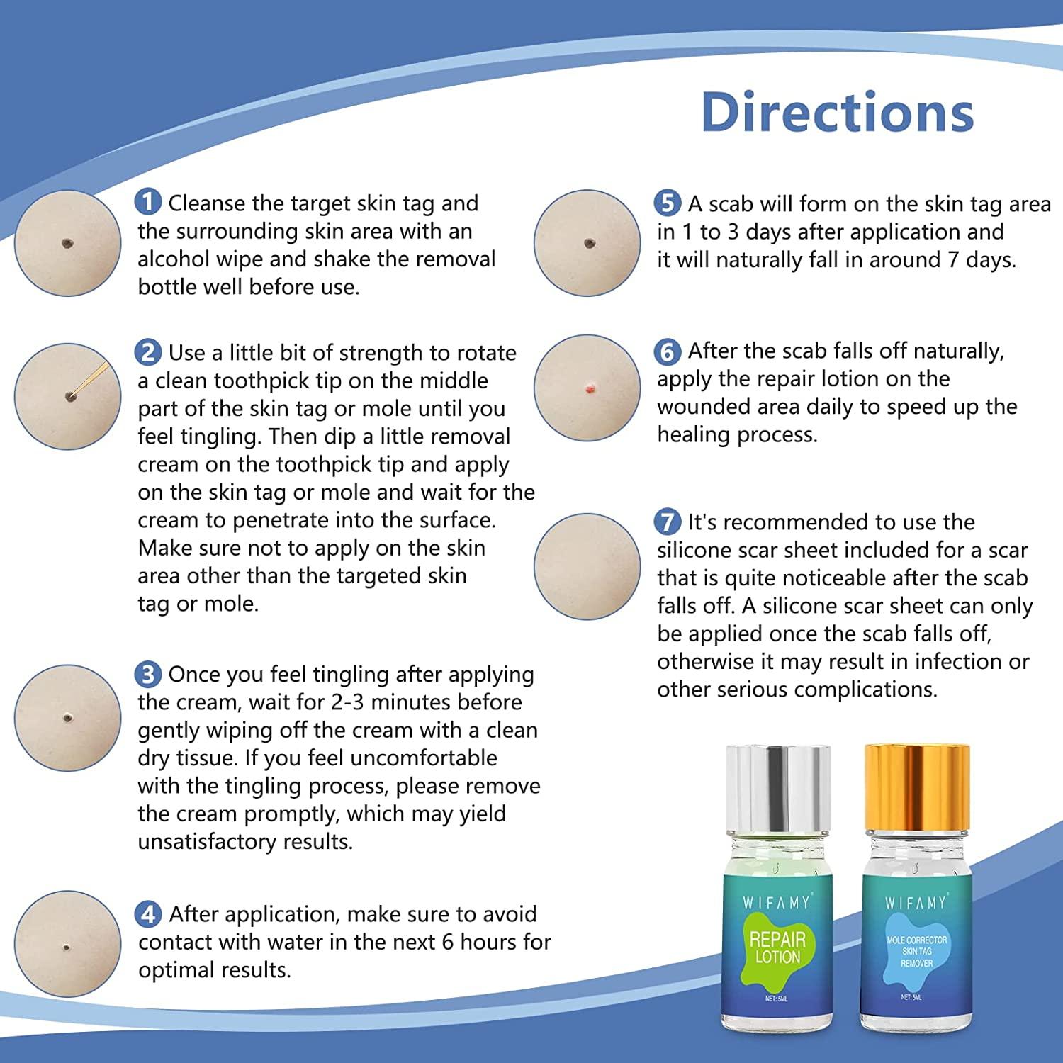 Skin Tag & Mole Remover Kit - Remove Without Scars | Skin Tag Removal ...