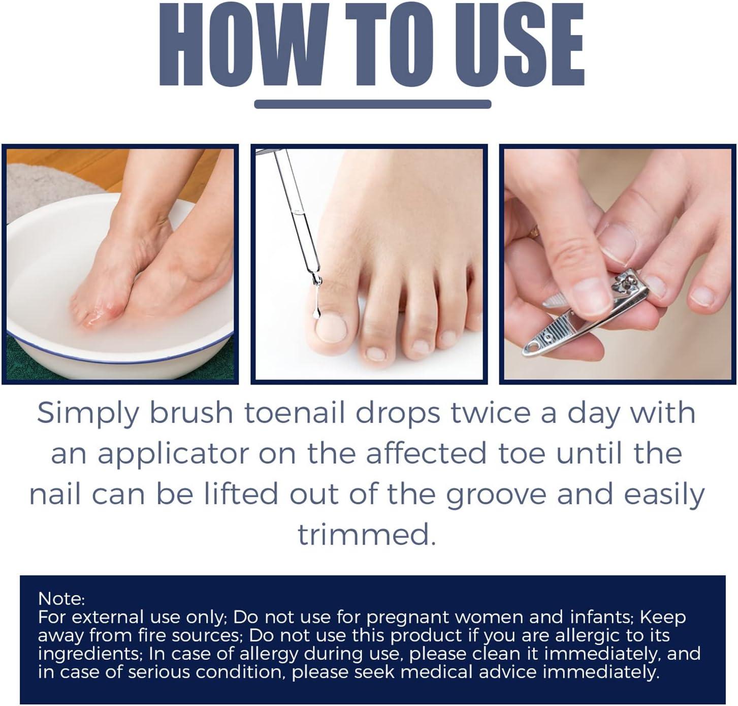 German Ingrown Toenail Drop: Paronychia Oil for Toenail Care - Nail ...