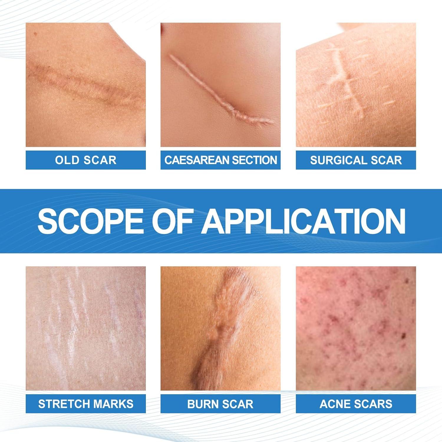 Silicone Scar Gel - Scar Removal Cream - 30g Scar Cream - Scar Removal ...