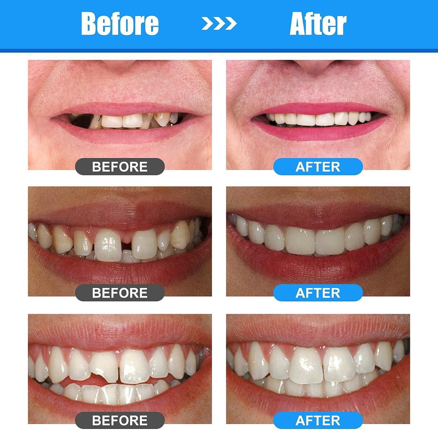 Temporary Tooth Repair Kit | Fix Missing & Broken Teeth | 4 Dental ...