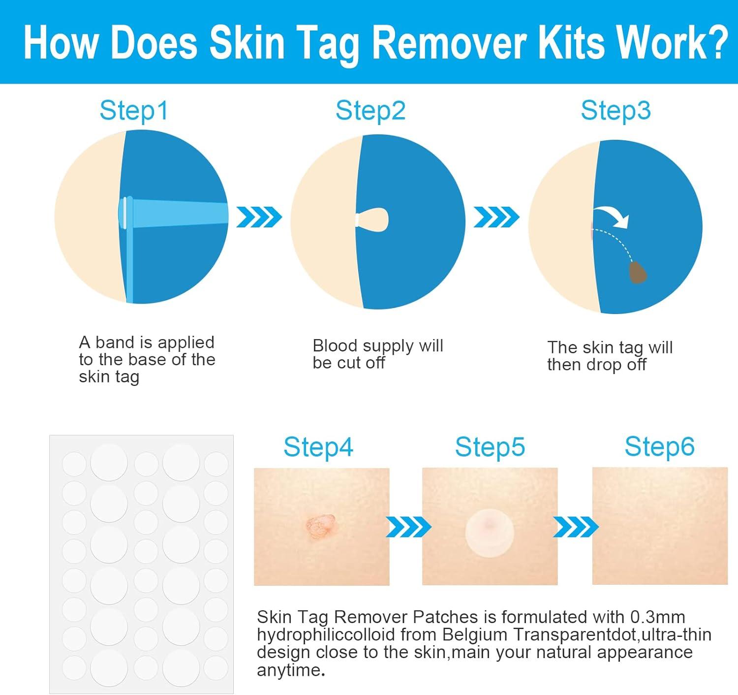 Painless 2-in-1 Skin Tag Removal Kit for Micro to Large Skin Tags (1 ...