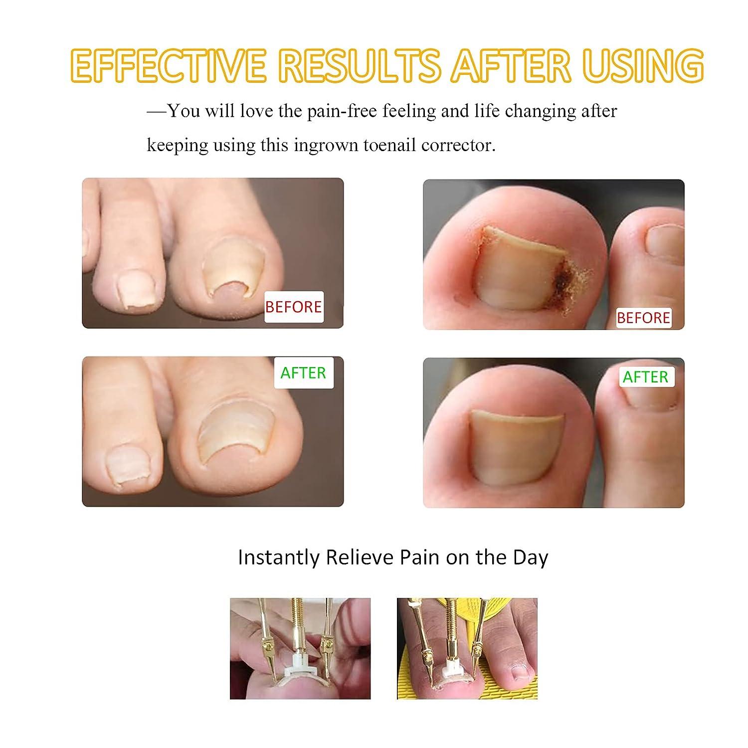 Ingrown Toenail Treatment Kit - Stainless Steel Corrector for Curved ...