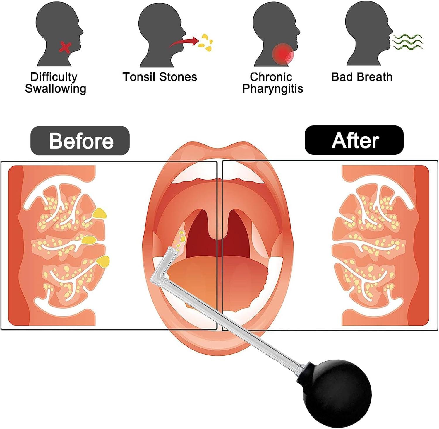 Tonsillenstein Remover Tool - Manual Tonsil Stone Cleaner for Fresh ...