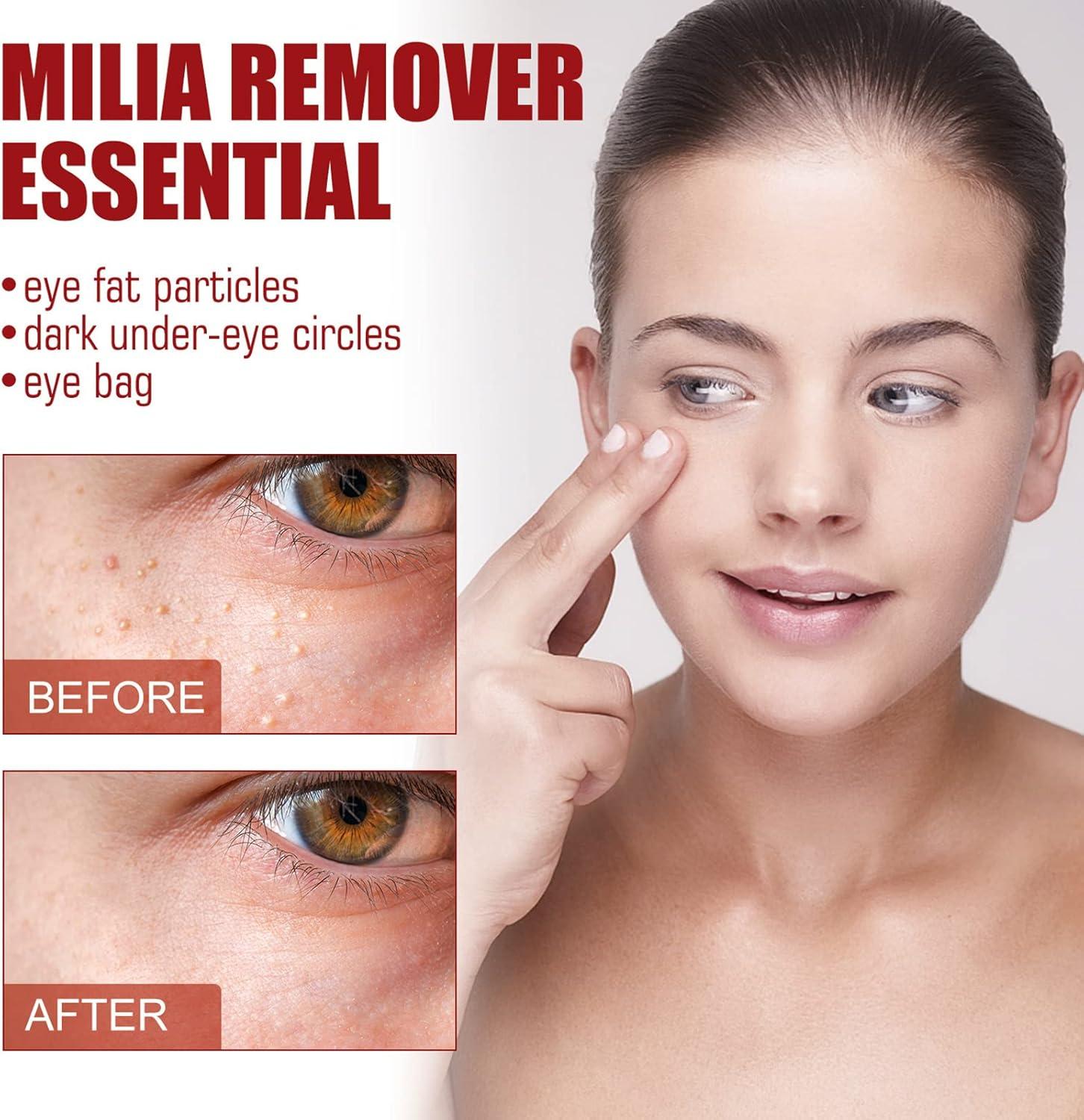 KOAHDE Milia Removal Face Serums Milia Spot Treatment Milia Treatment ...