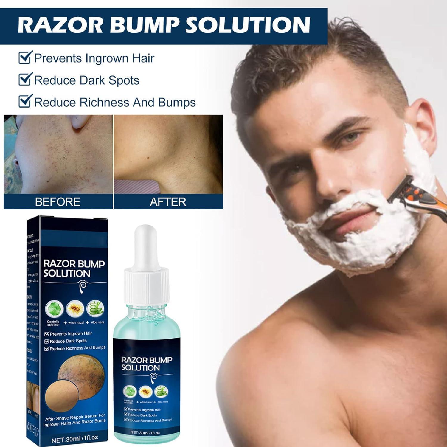 Ingrown Hair Treatment - 30ml Razor Bumps Solution | Mild Moisturizing ...