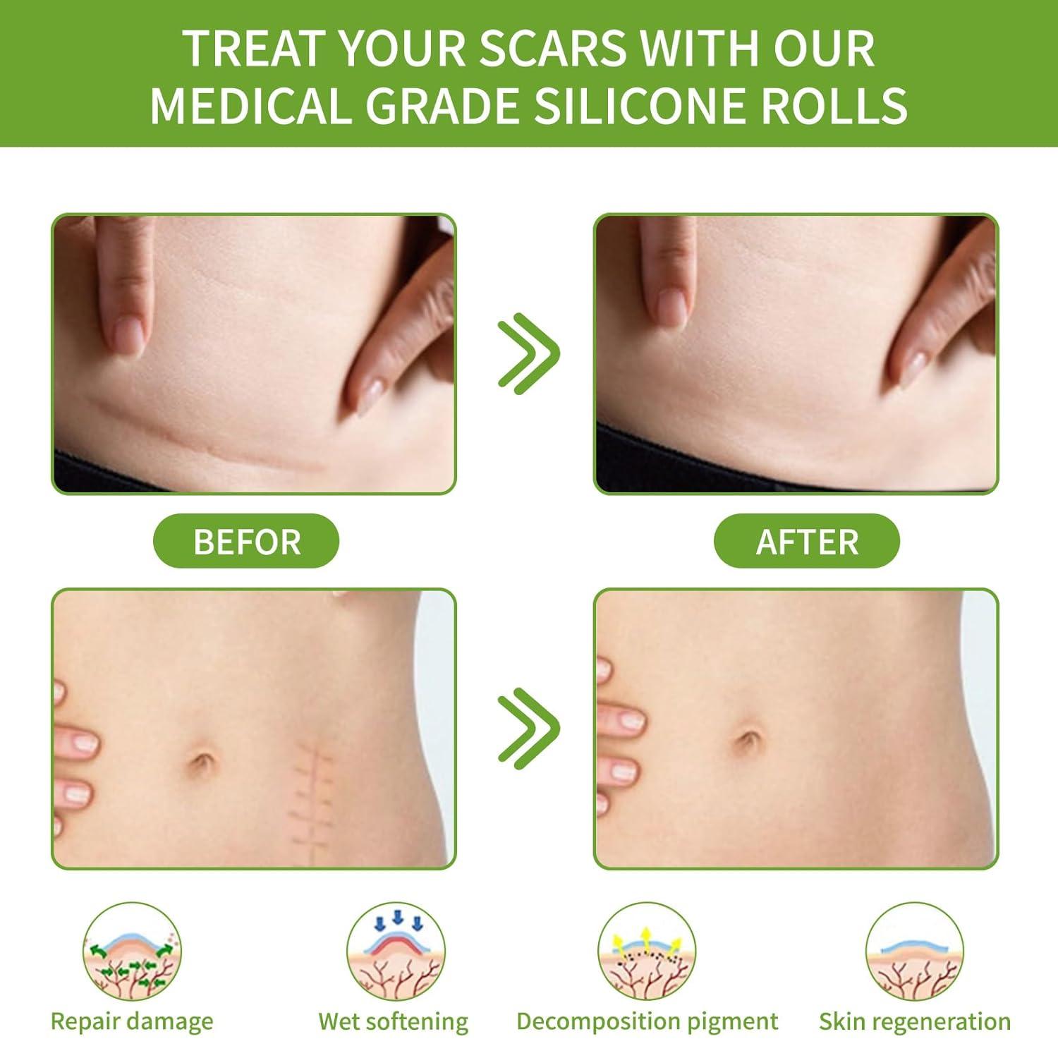 Premium Silicone Scar Tape - Medical-Grade Pain-Free Solution for All ...