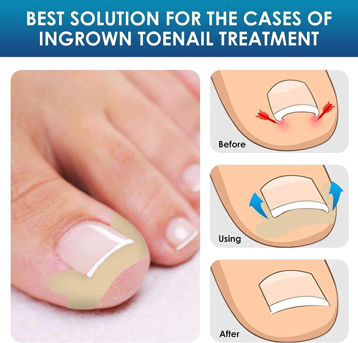 Ingrown Toenail Treatment Kit - 50Pcs Corrector Patch, File, and Lifter ...