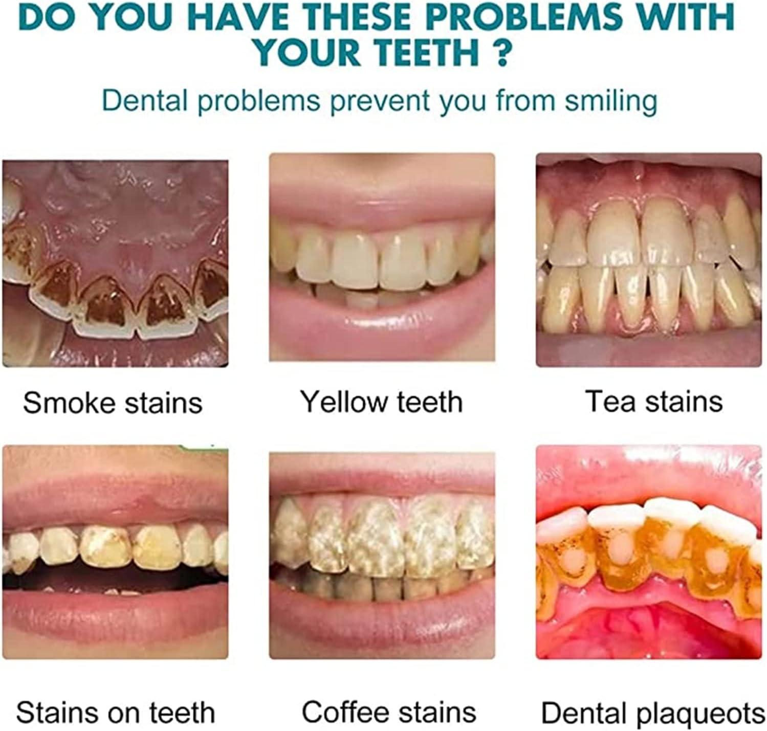 Tooth Paint & Whitening Gel Lacquer - Instant Brightening & Stain ...
